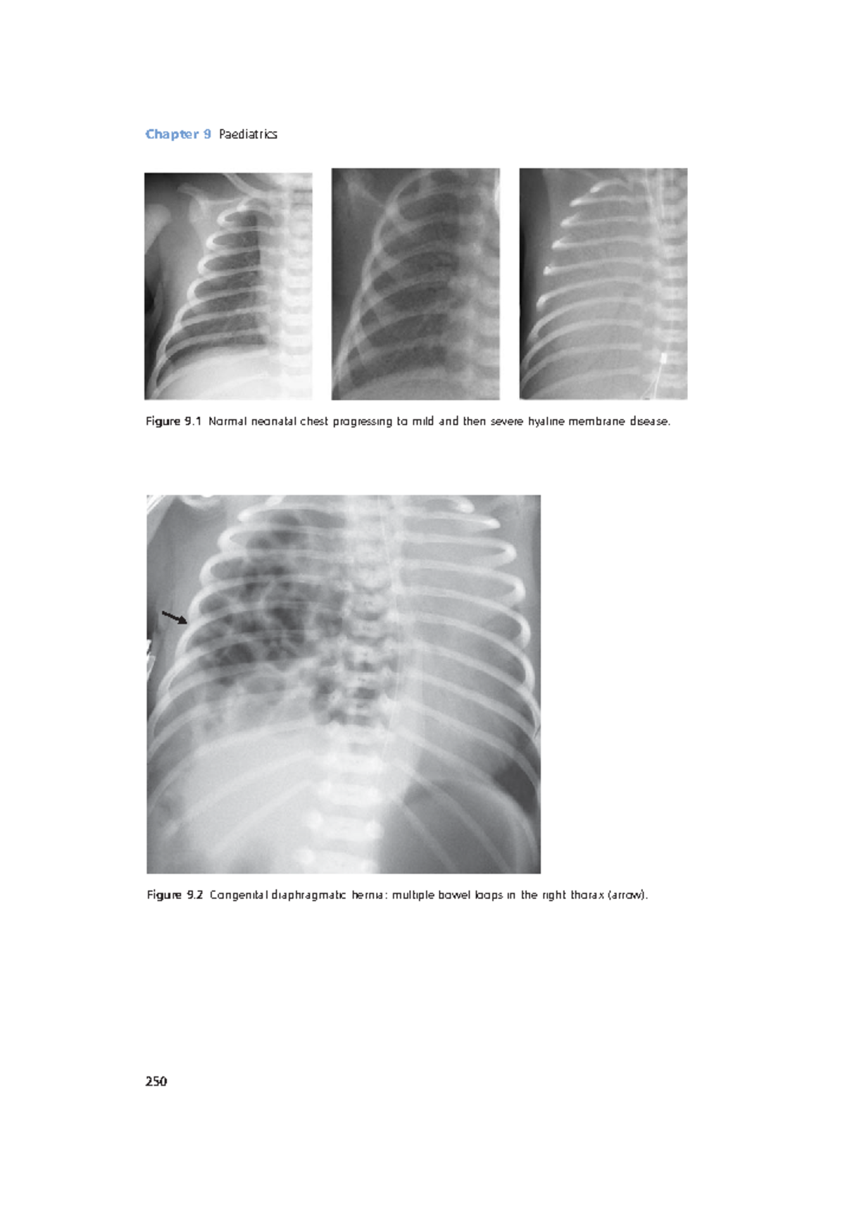 Radiology Lecture Notes pdf (84) - 250 Figure 9 Normal neonatal chest ...