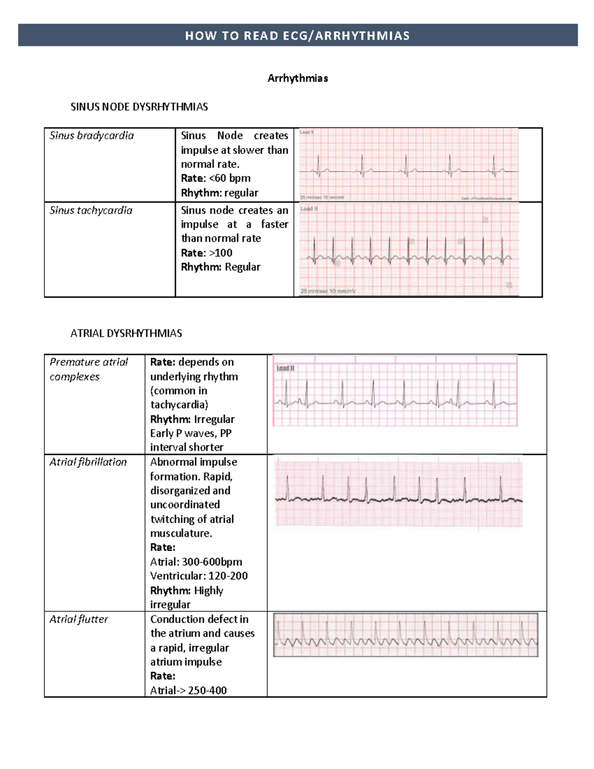 Adult III Arrhythmia Study Sheet - Arrhythmias SINUS NODE DYSRHYTHMIAS Sinus bradycardia Sinus ...
