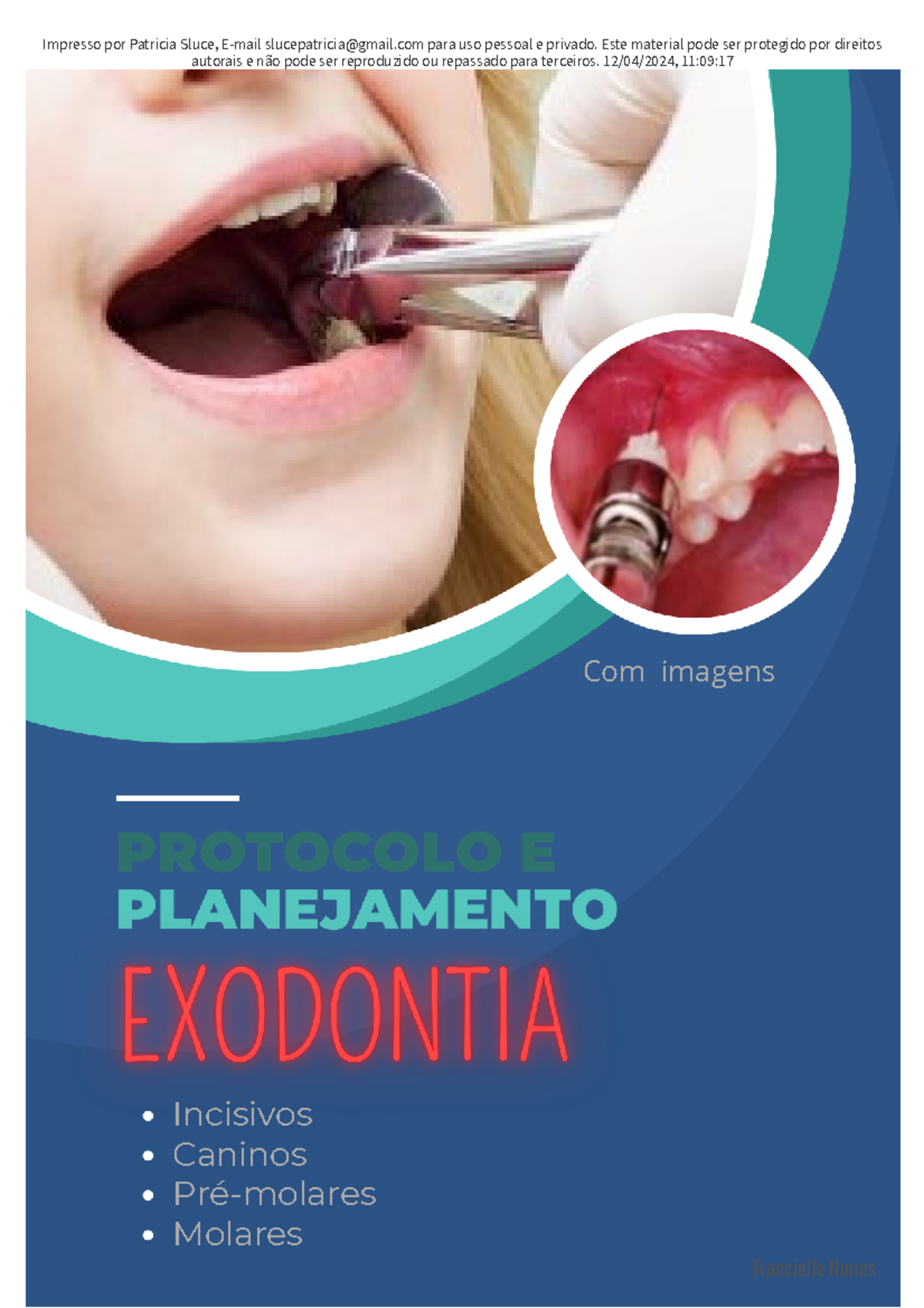 Protocolo e planejamento Exodontia (todos os dentes superiores e ...