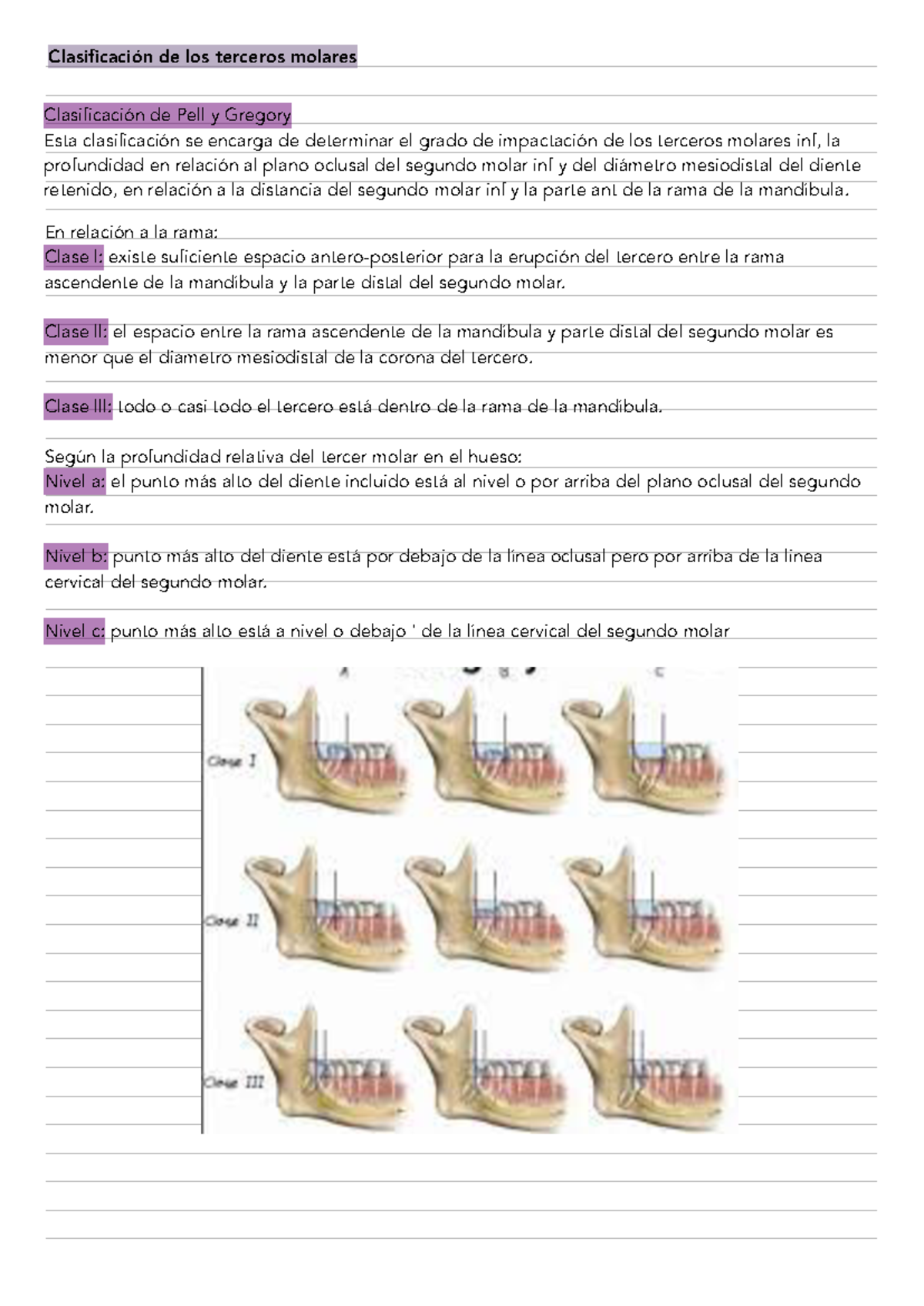 Terceros molares clasificación - Clasificación de los terceros molares ...