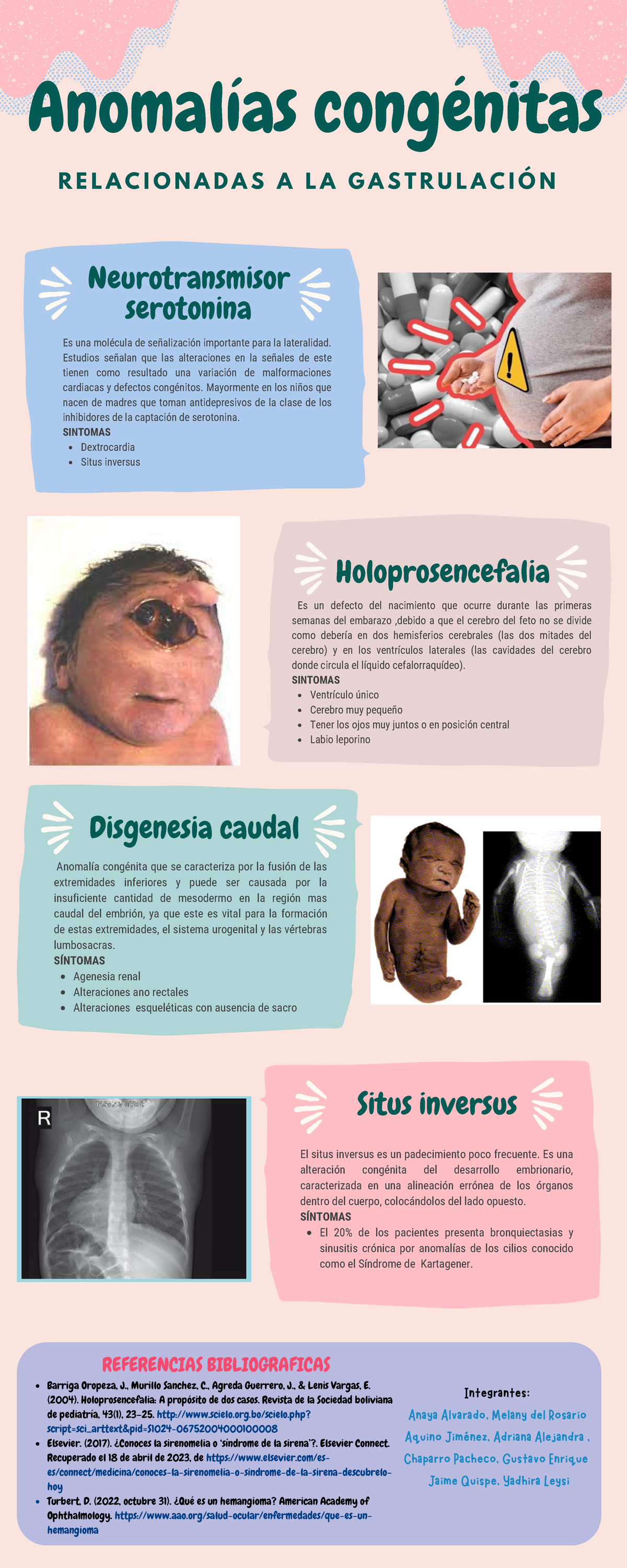 Infografia anomalias - Neurotransmisor serotonina Holoprosencefalia Situs inversus Disgenesia ...