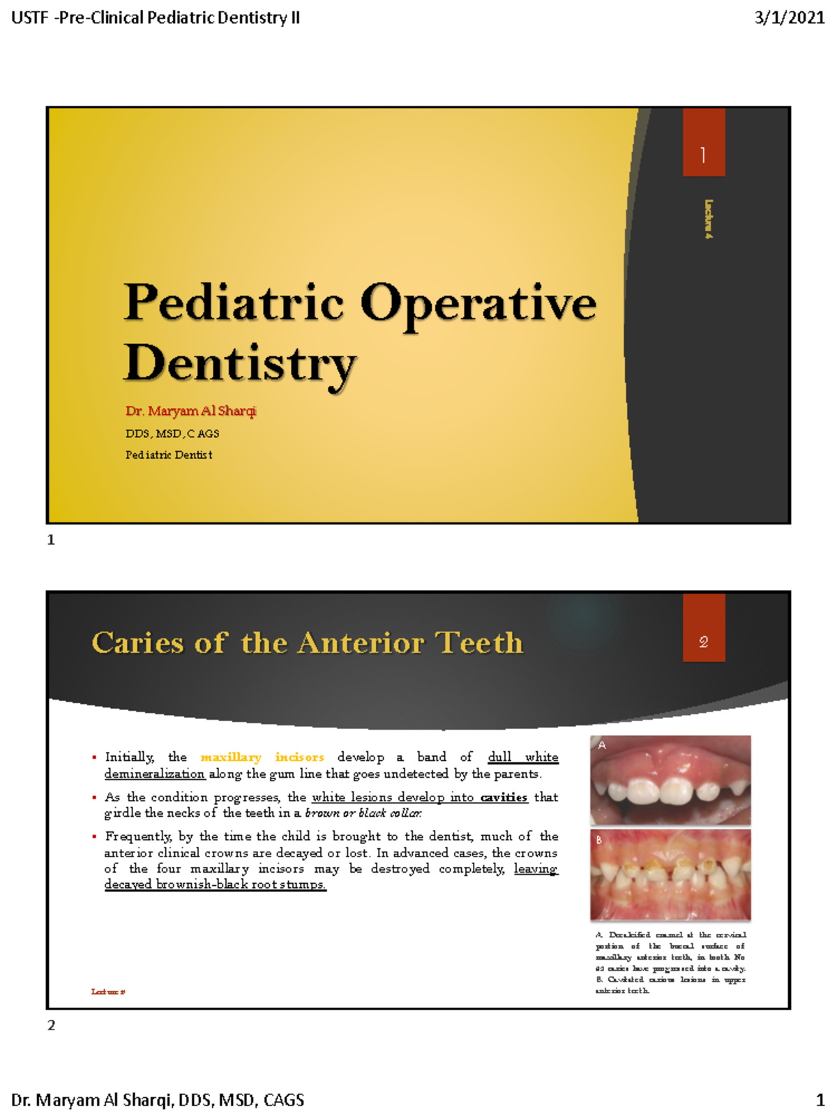 4th lecture - Pediatric Operative Dentistry Part 2 Class III IV, V ...