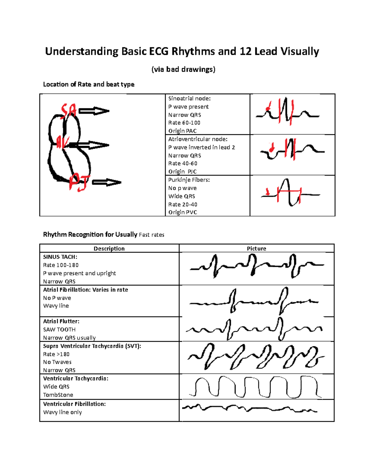 ECG quick look clinical document - Understanding Basic ECG Rhythms and ...