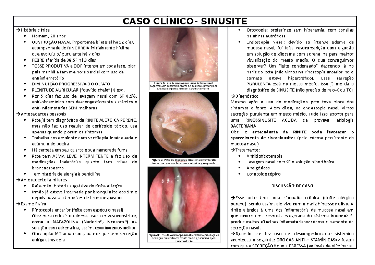 Resumo- CASO Clínico Sinusite - CASO SINUSITE Homem, 20 anos NASAL ...