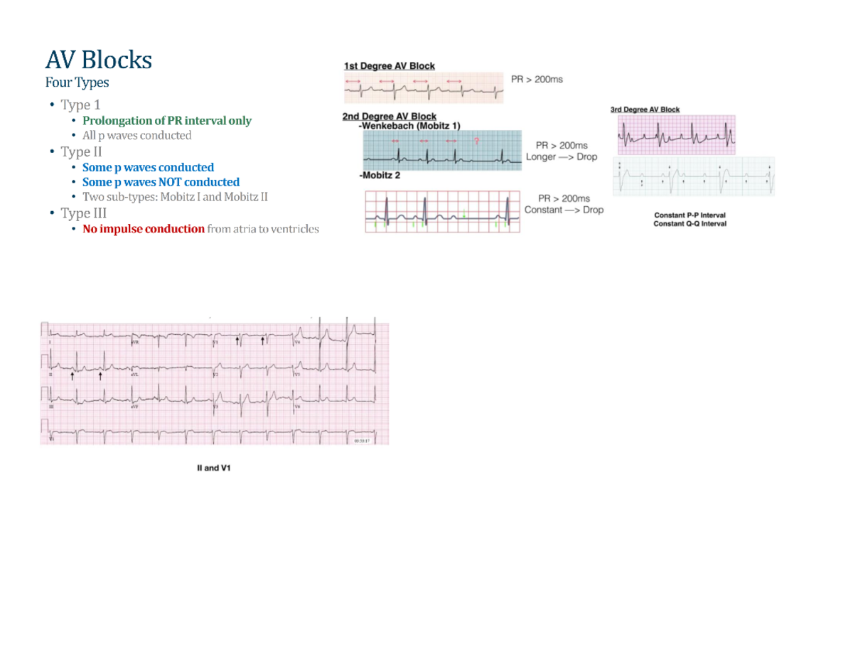 Dirty - ekg - AV Blocks 1st Degree AV Block Four Types PR 200ms Type 1 ...