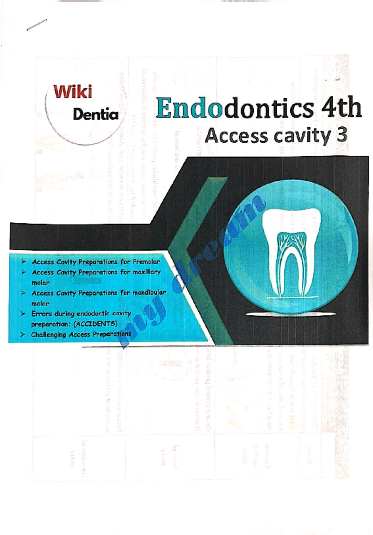 [Endo] Access Cavity Part 3 - Wiki Dentia Endodontics 4th Access cavity 3 Access Cavity ...