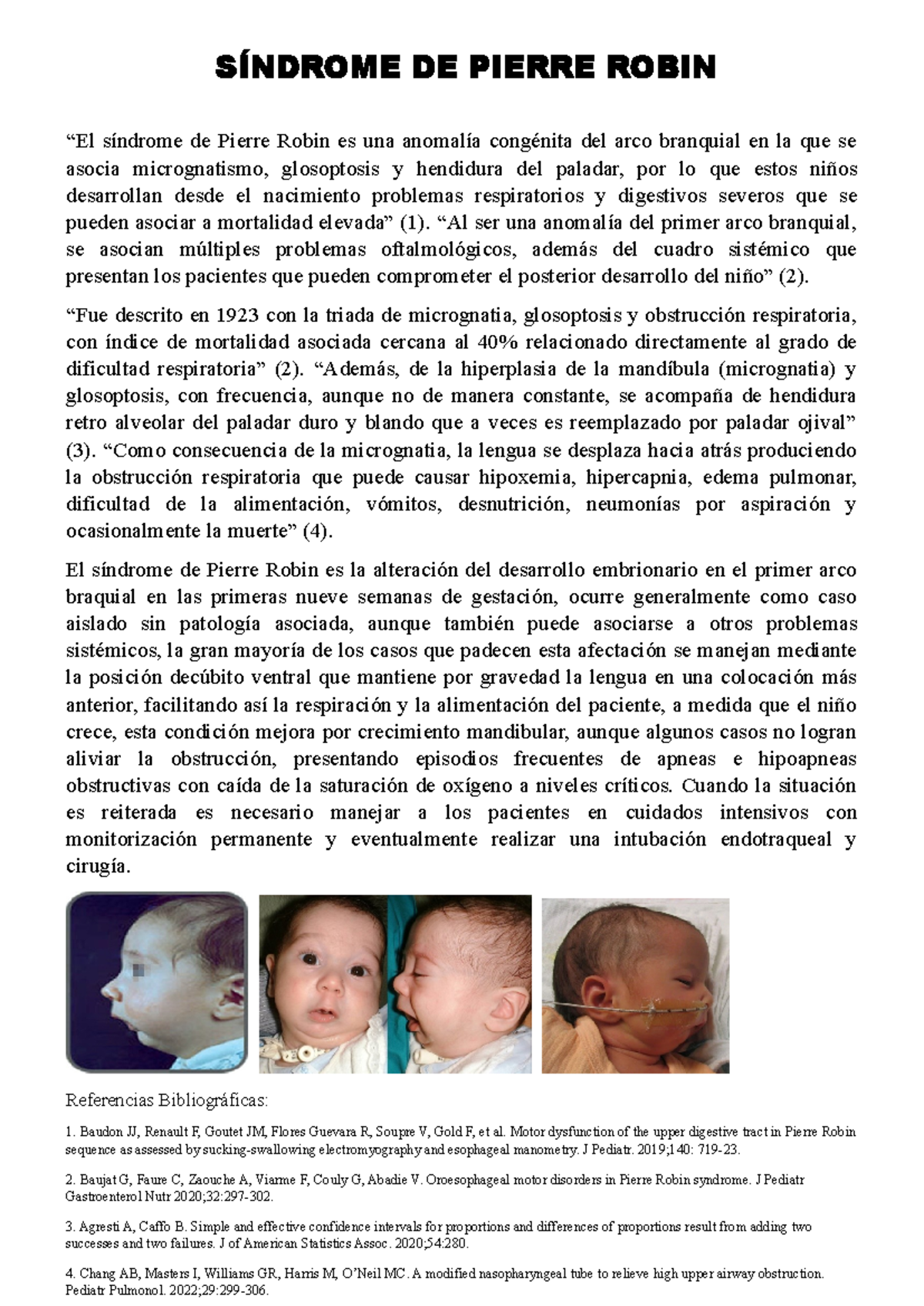 Síndrome DE Pierre Robin - SÍNDROME DE PIERRE ROBIN “El síndrome de ...