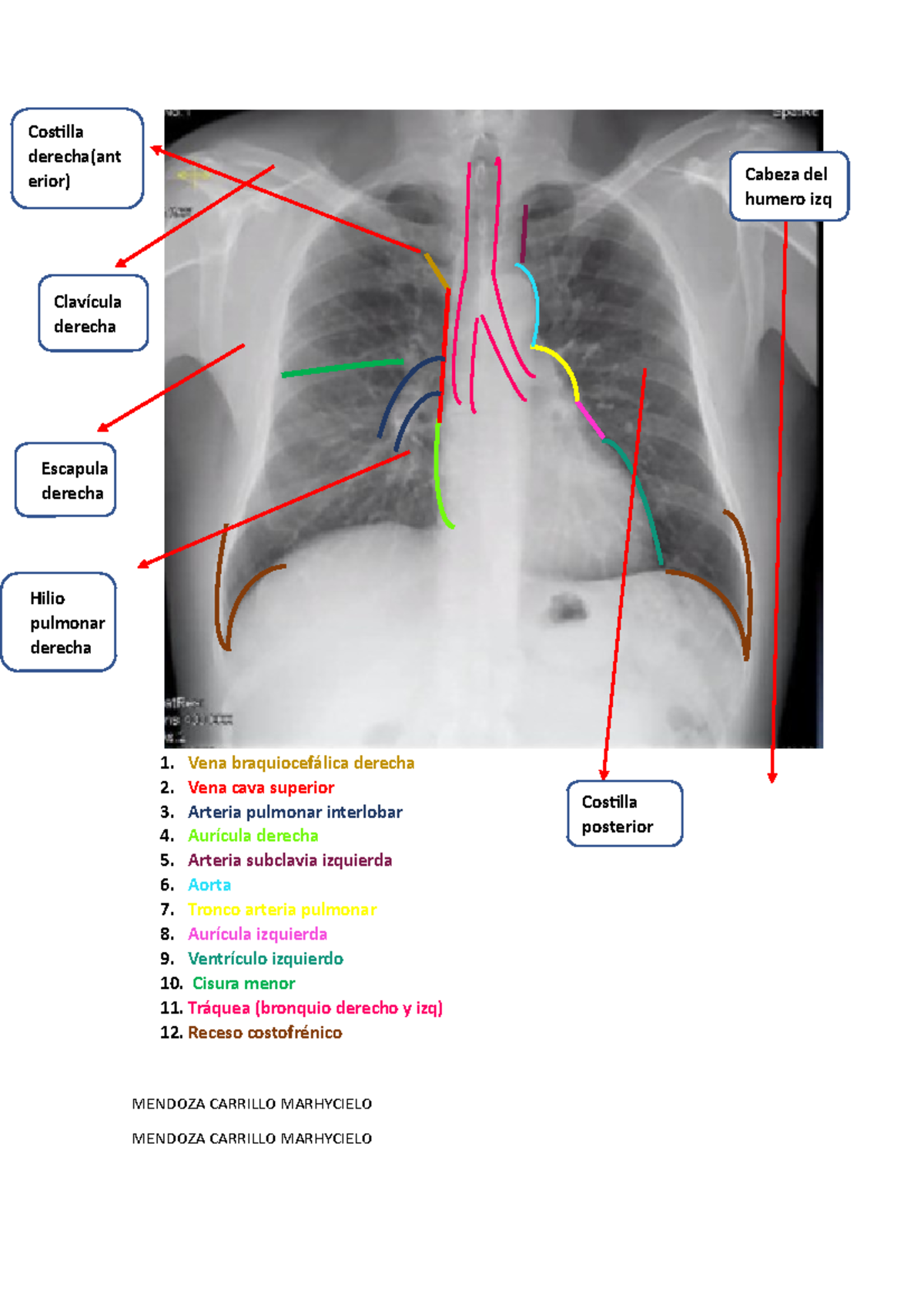 RX DE Torax Y Cuadro Comparativo - Vena braquiocefálica derecha Vena ...