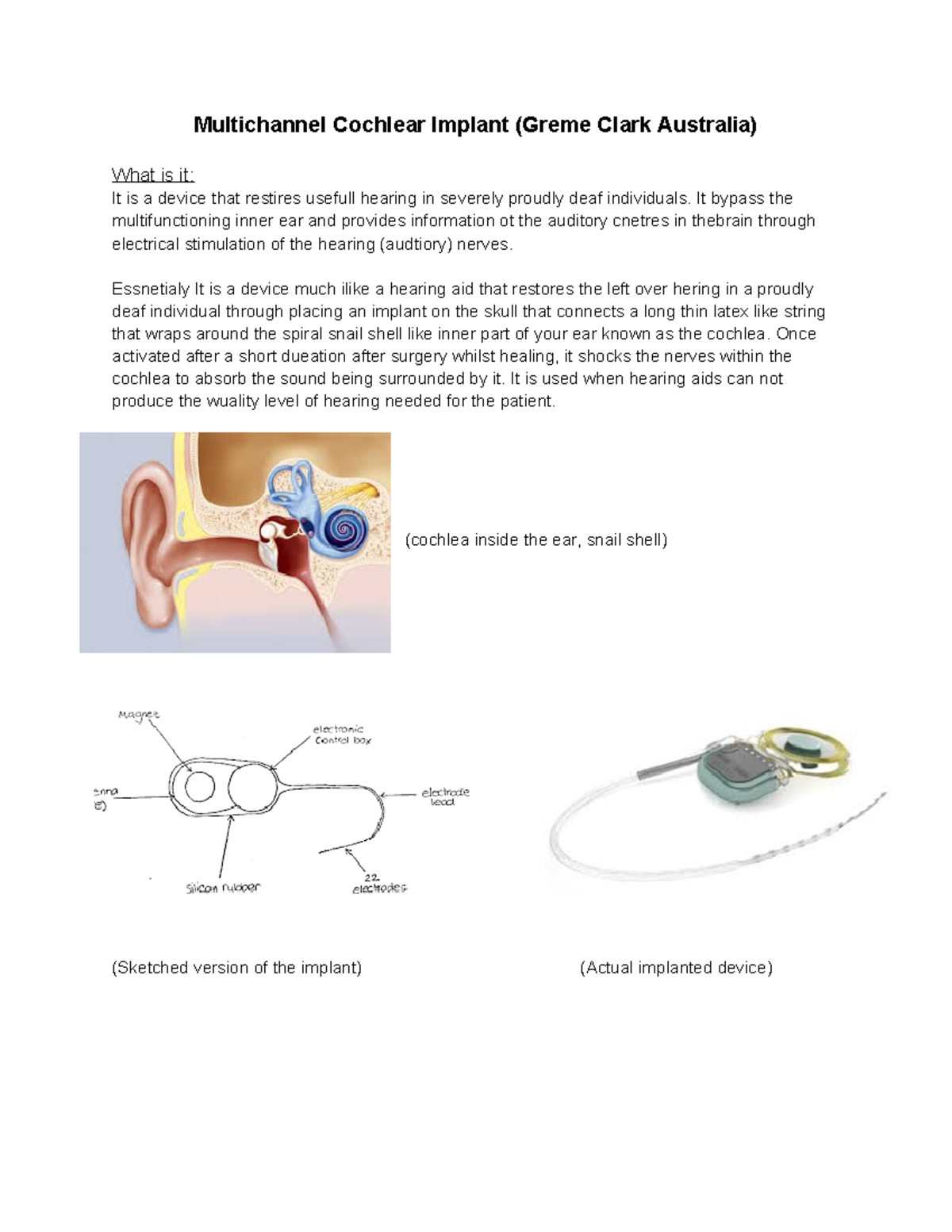 Cochlear Implant Research - Multichannel Cochlear Implant (Greme Clark ...