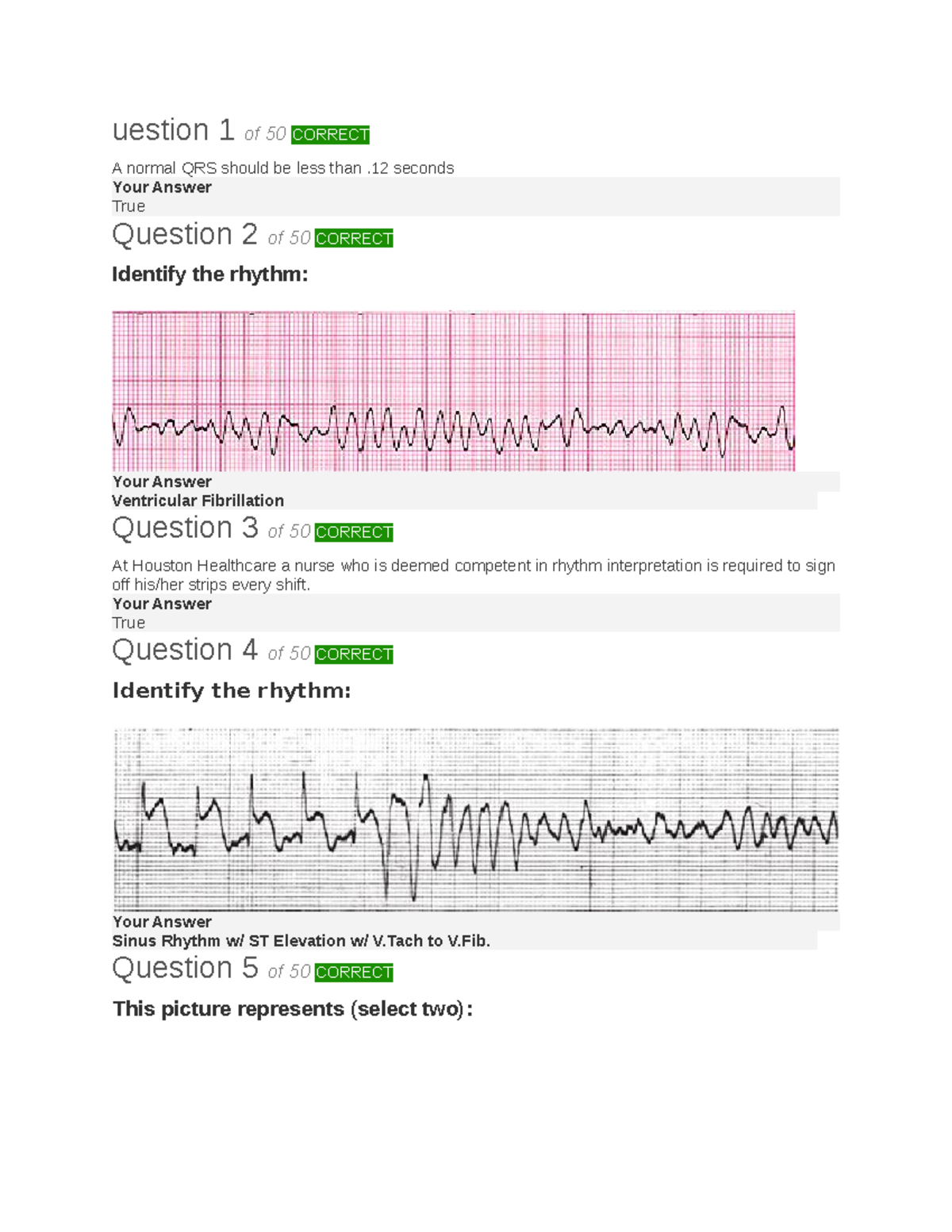 Cardiac EKG rhythm strips 2018 - uestion 1 of 50 CORRECT A normal QRS ...
