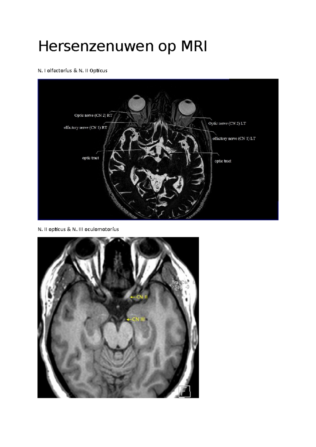 Hersenzenuwen op MRI - I olfactorius & N. II Opticus N. II opticus & N ...