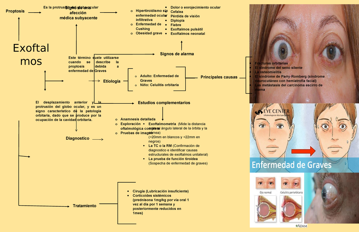 Exoftalmos - Mapa conceptual - Exoftal mos Proptosis El desplazamiento ...