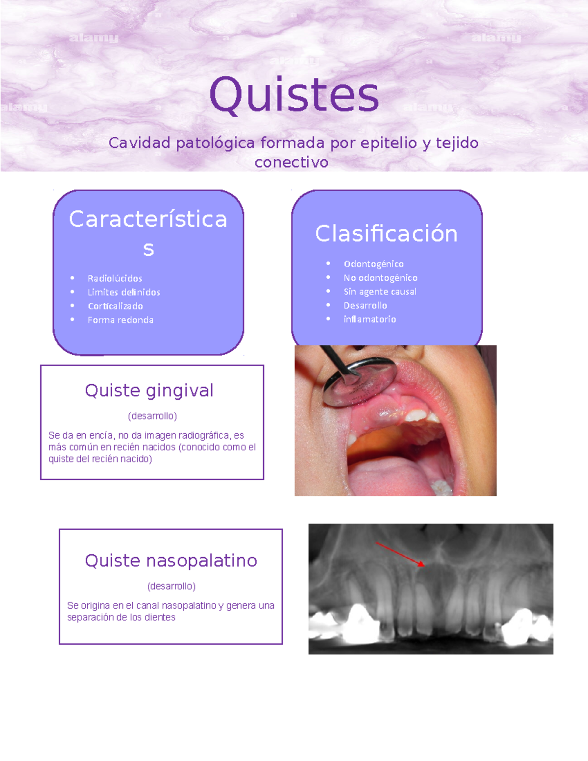 Quistes - Quistes Cavidad patológica formada por epitelio y tejido ...
