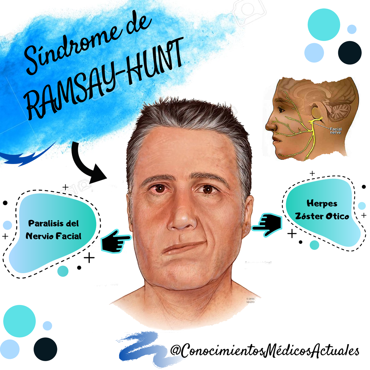 Sindrome Ramsay HUNT - Resumen Medicina humana - Síndrome de RAMSAY ...
