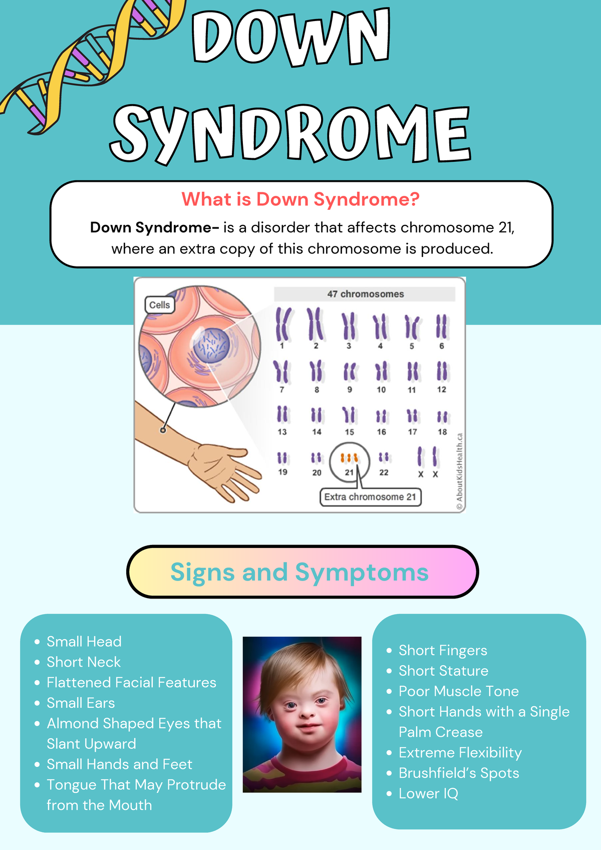 Down Syndrome - Infographic - DOWNDOWN SYNDROMESYNDROME What is Down ...