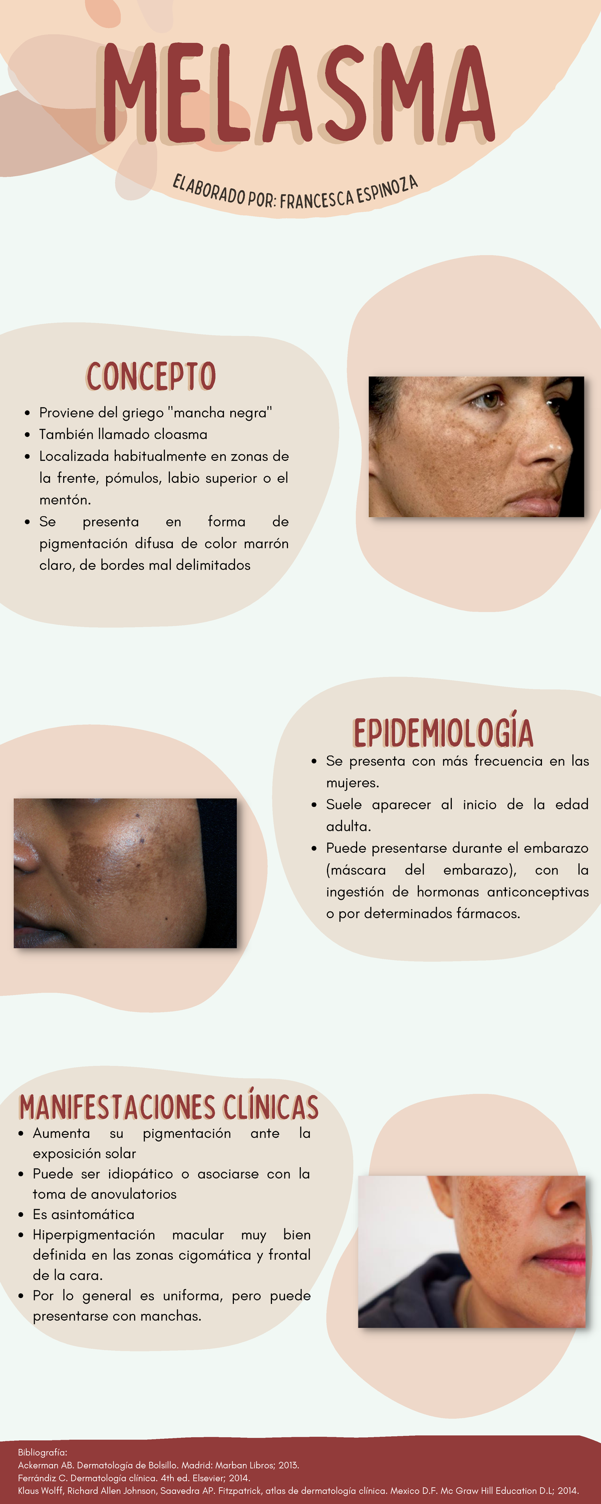 Melasma y sus características - MELASMAMELASMA CONCEPTOCONCEPTO ...