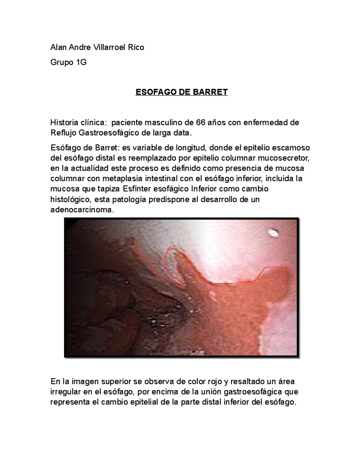 Esofago de Barret 2 - pato esp - Alan Andre Villarroel Rico Grupo 1G ...