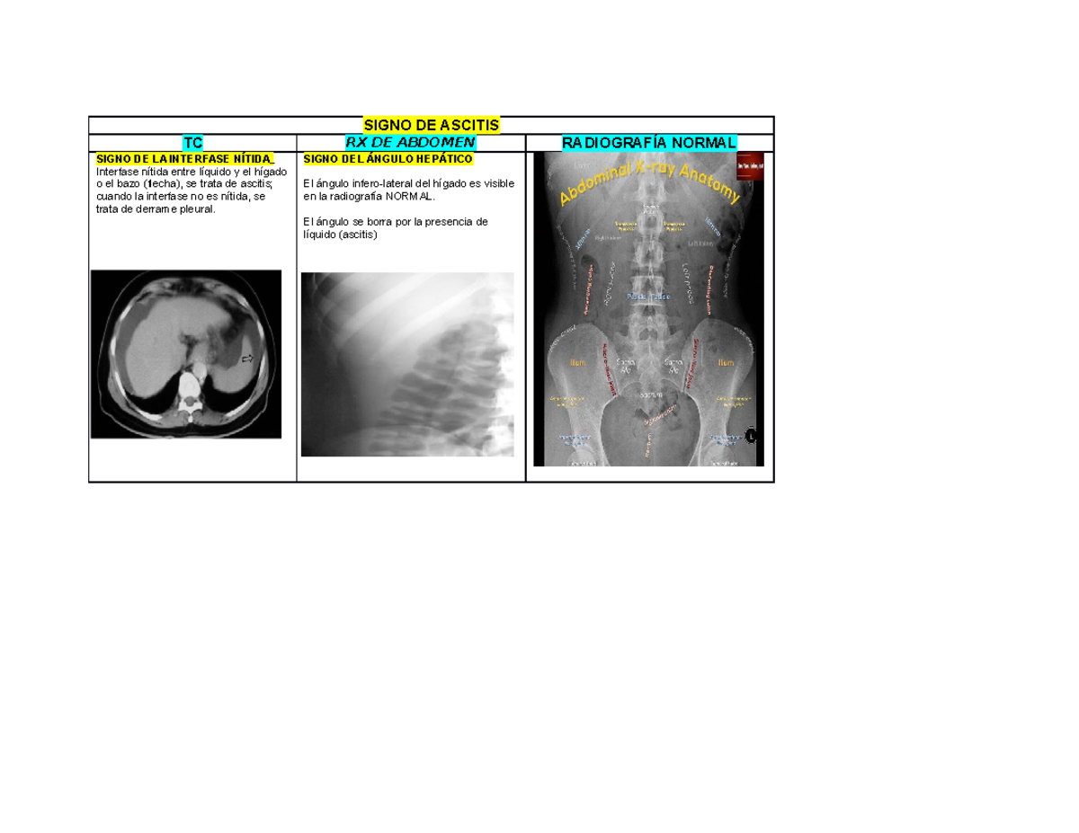 Signo DE Ascitis - Lecture notes radiología - SIGNO DE ASCITIS TC RX DE ...