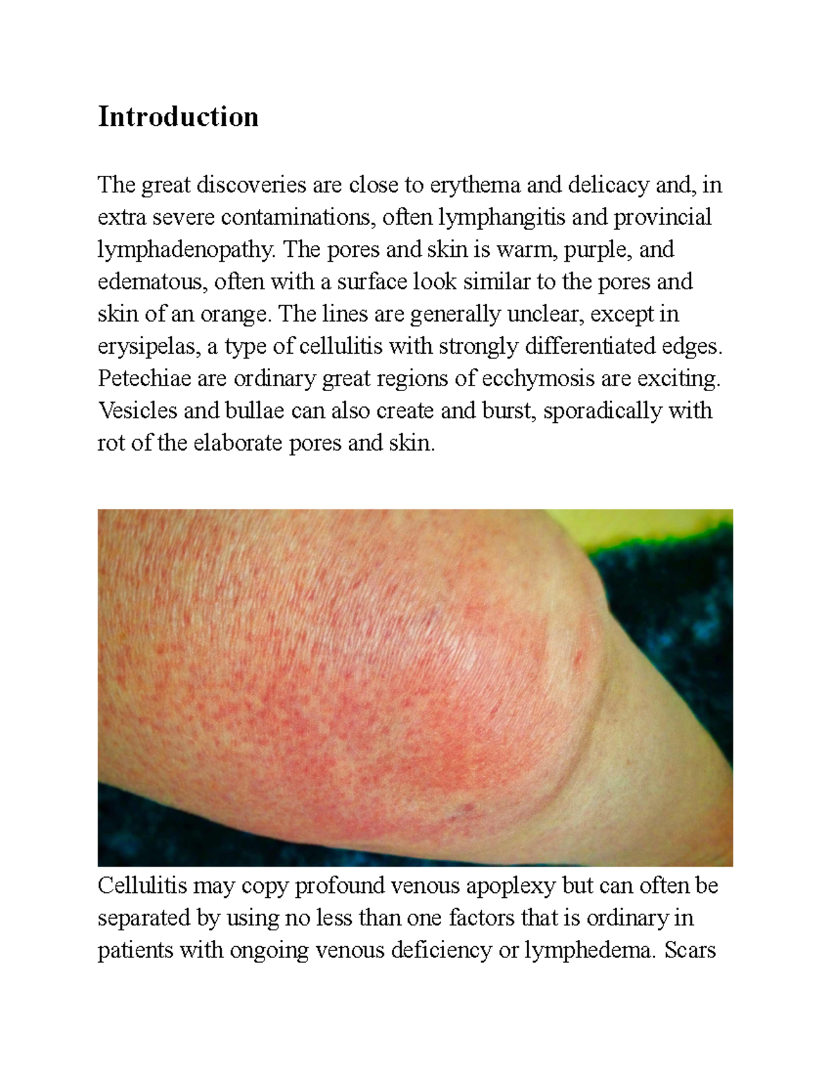 Cellulitis summary - Introduction The great discoveries are close to erythema and delicacy and ...