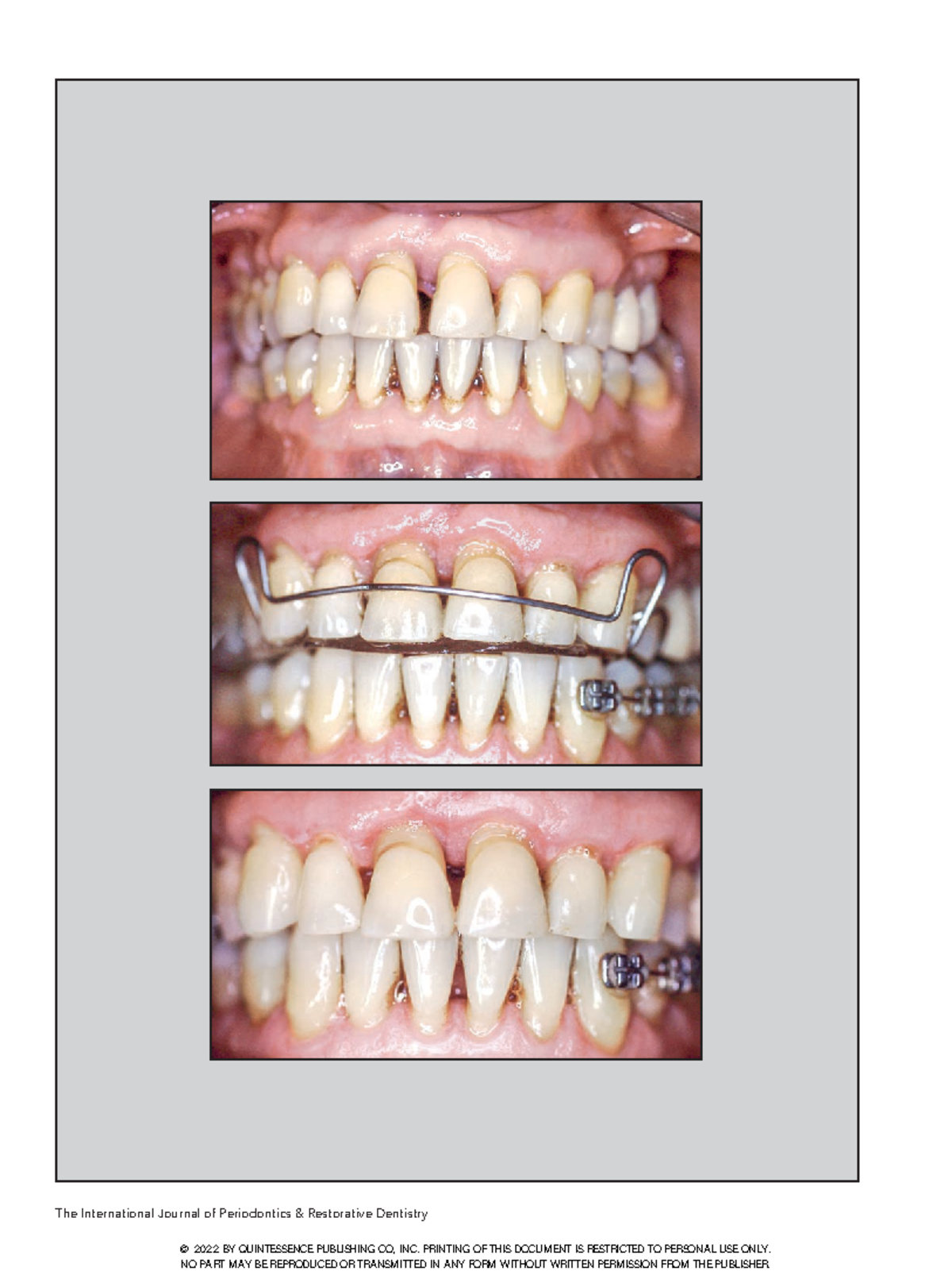 266379442688766495469336575 - The International Journal of Periodontics ...