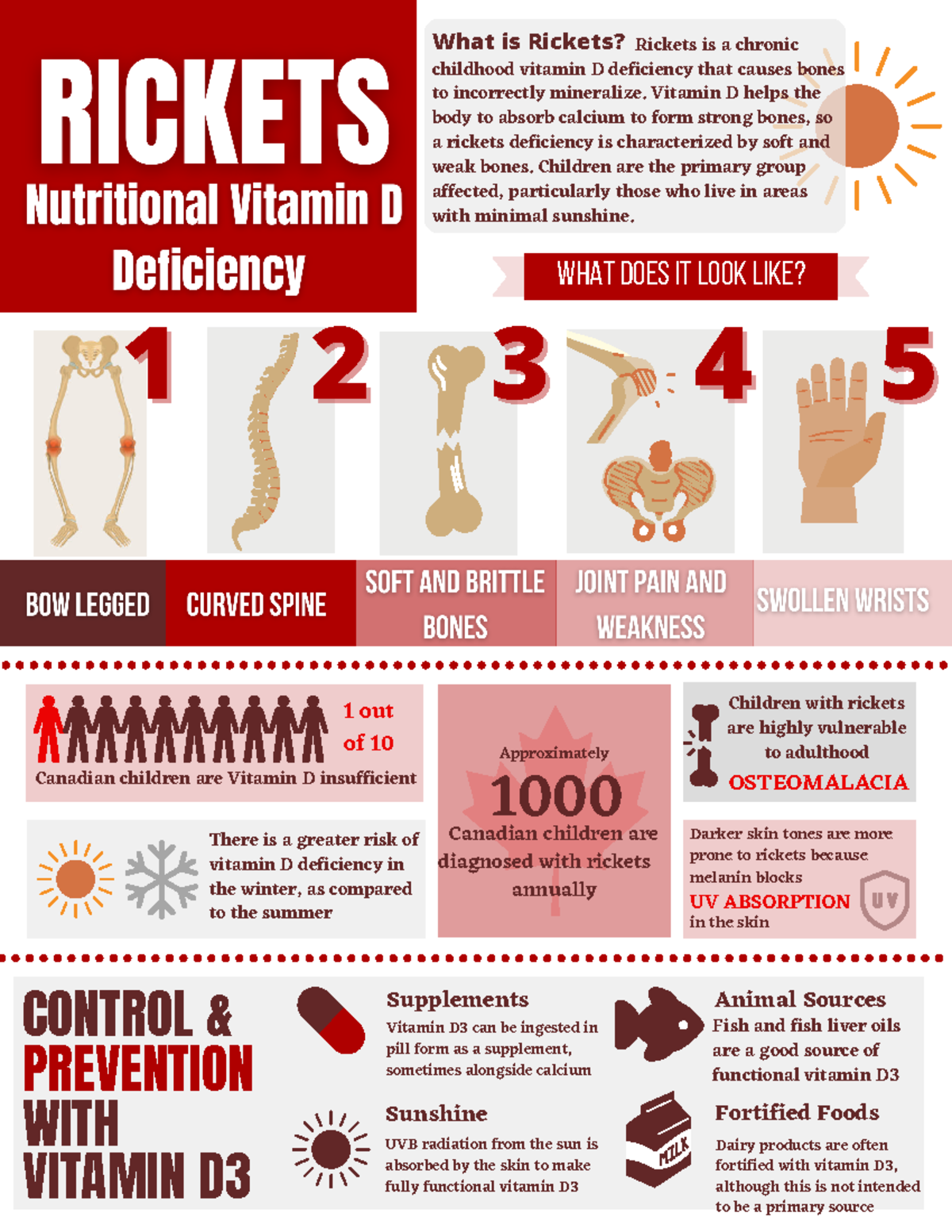 NUTR 3210 - Infographic - 1 out of 10 What is Rickets? Rickets is a ...