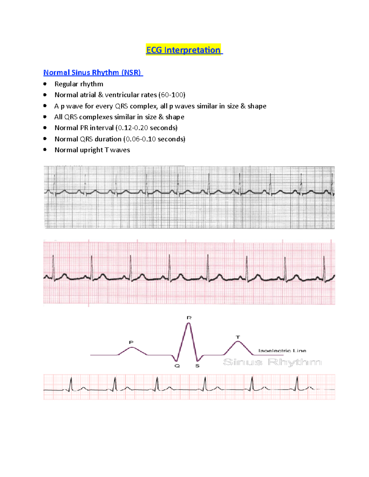 ECG Interpretation - Lecture Notes - ECG Interpretation Normal Sinus ...