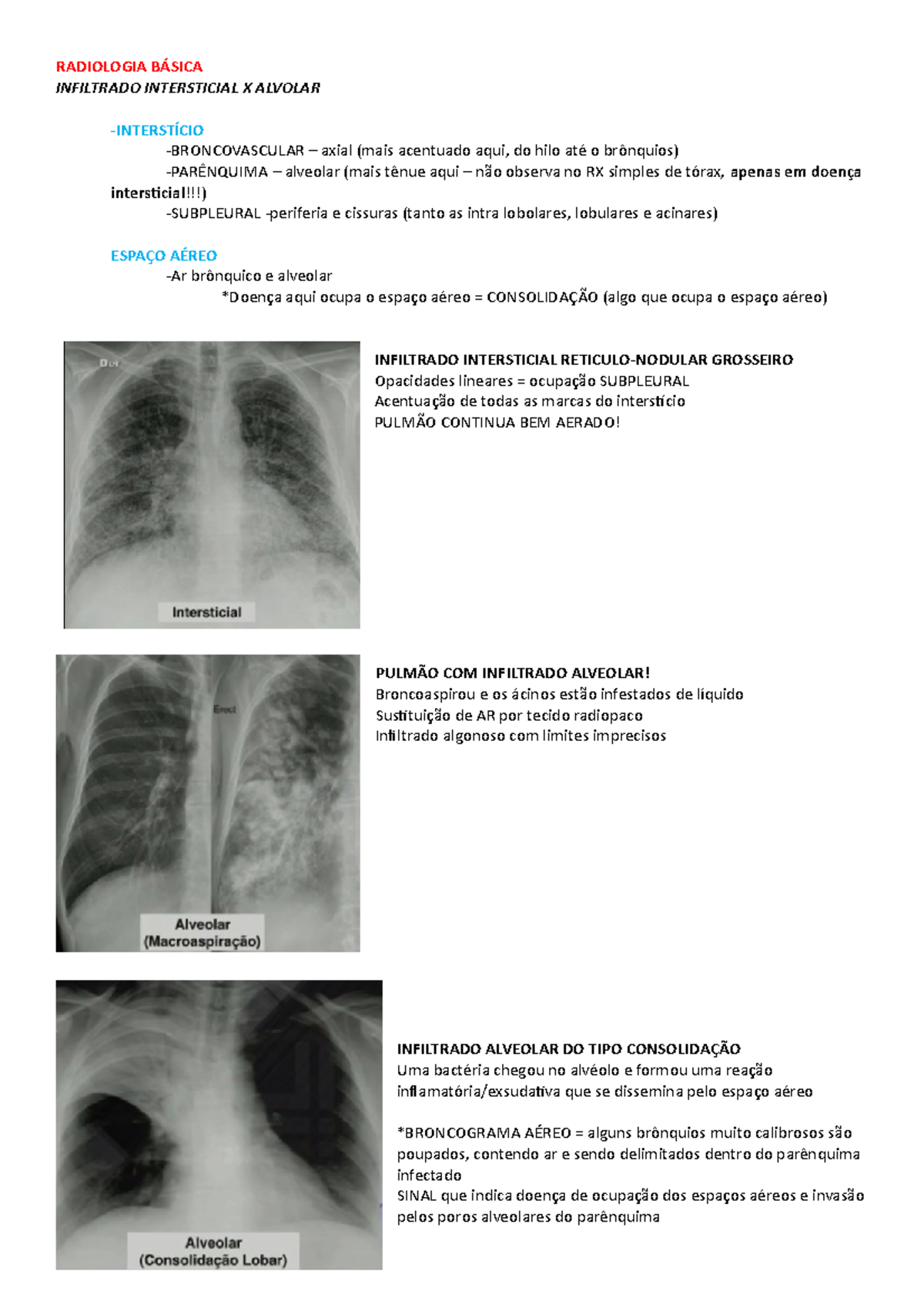 Radiologia Intersticial E Alveolar - RADIOLOGIA BÁSICA INFILTRADO ...