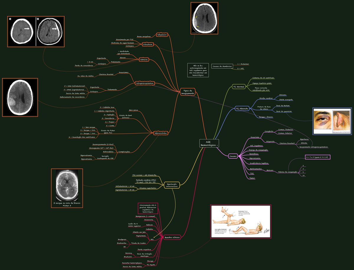 AVC Hemorrágico - Mapa mental de matéria de urgência e emergência. - Subgaleano Bossa Geralmente ...