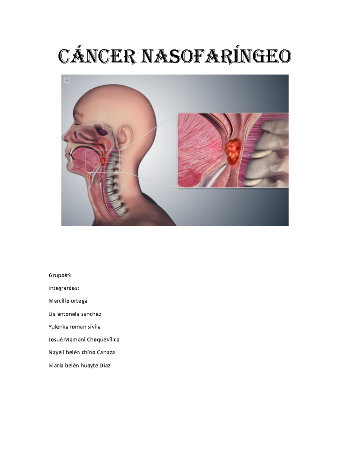 Cáncer nasofaríngeo - CánCer nasofaríngeo Grupo# Integrantes: Marcilio ...