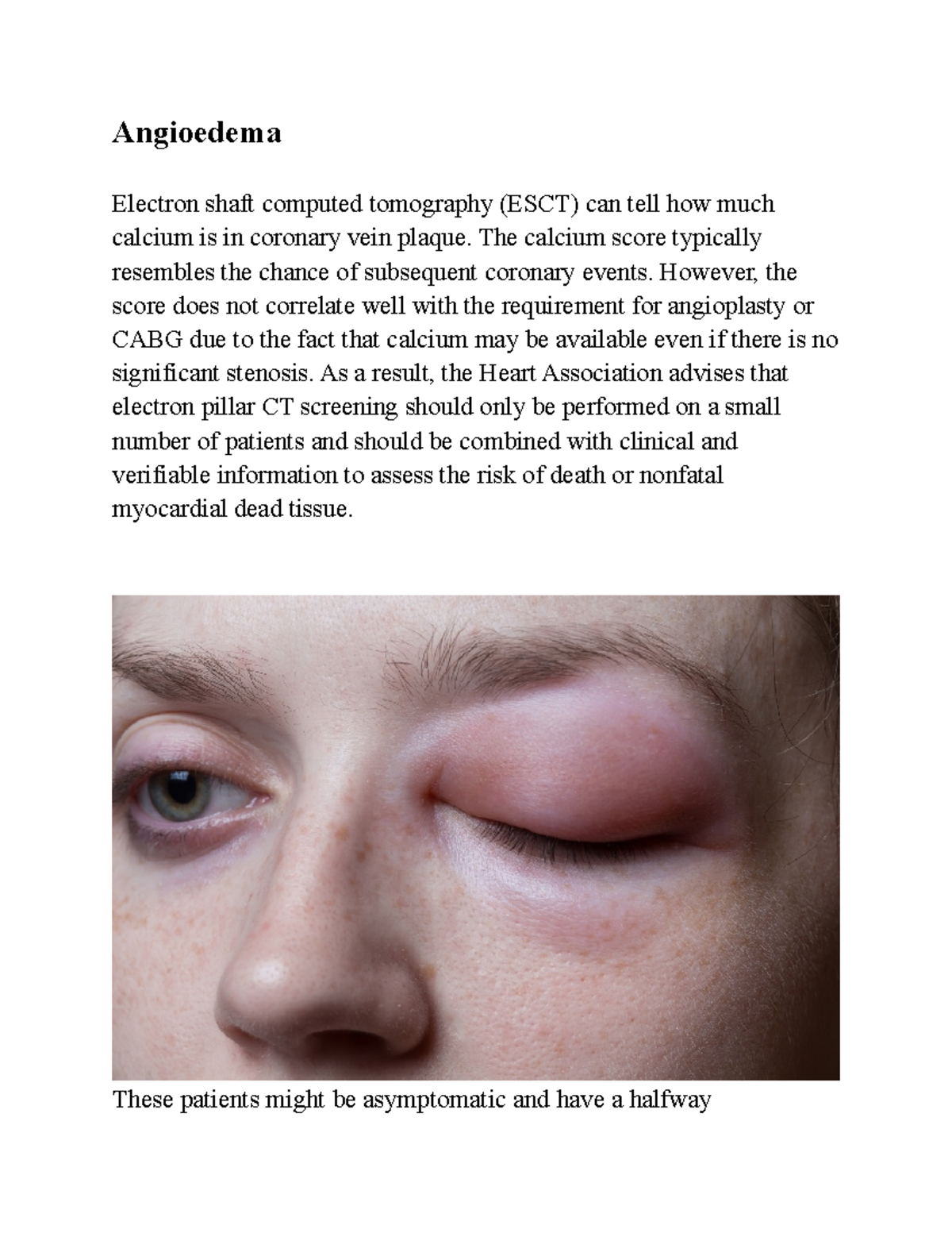 Angioedema - Angioedema Electron shaft computed tomography (ESCT) can ...