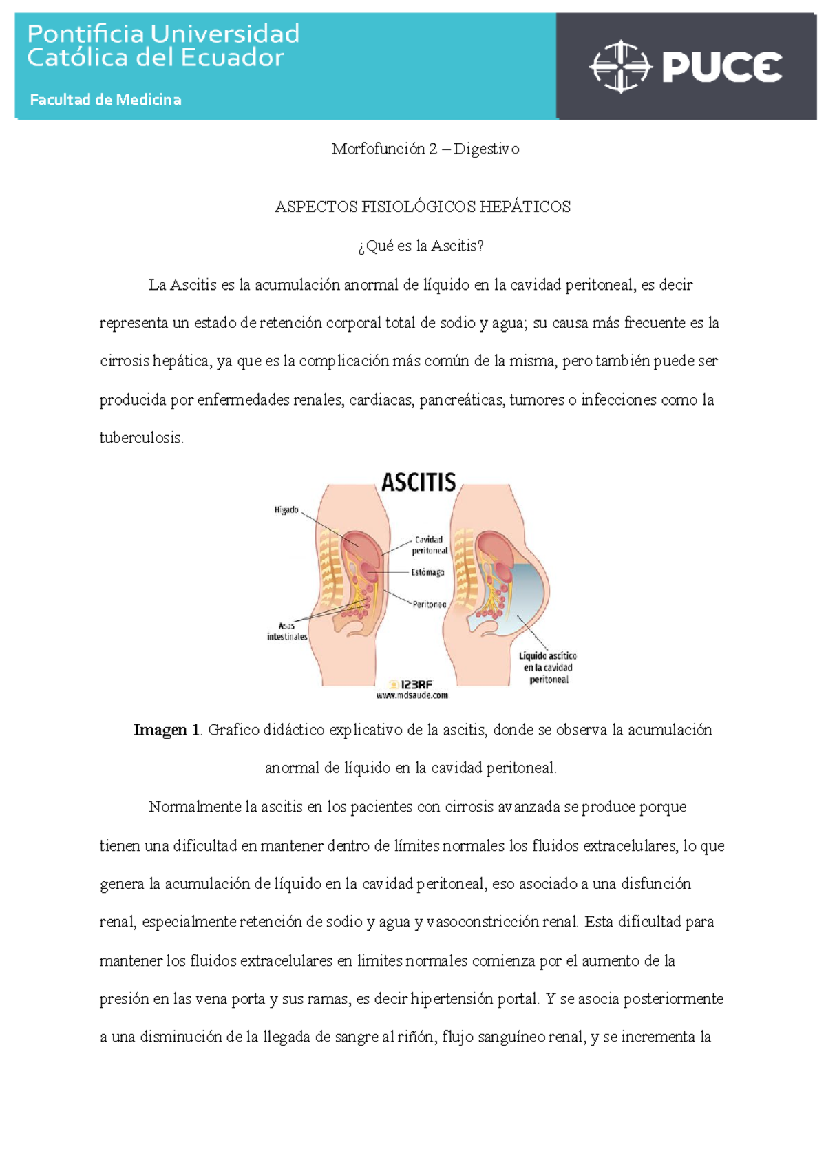 Ascitis - Imagen 1. Grafico didáctico explicativo de la ascitis, donde ...