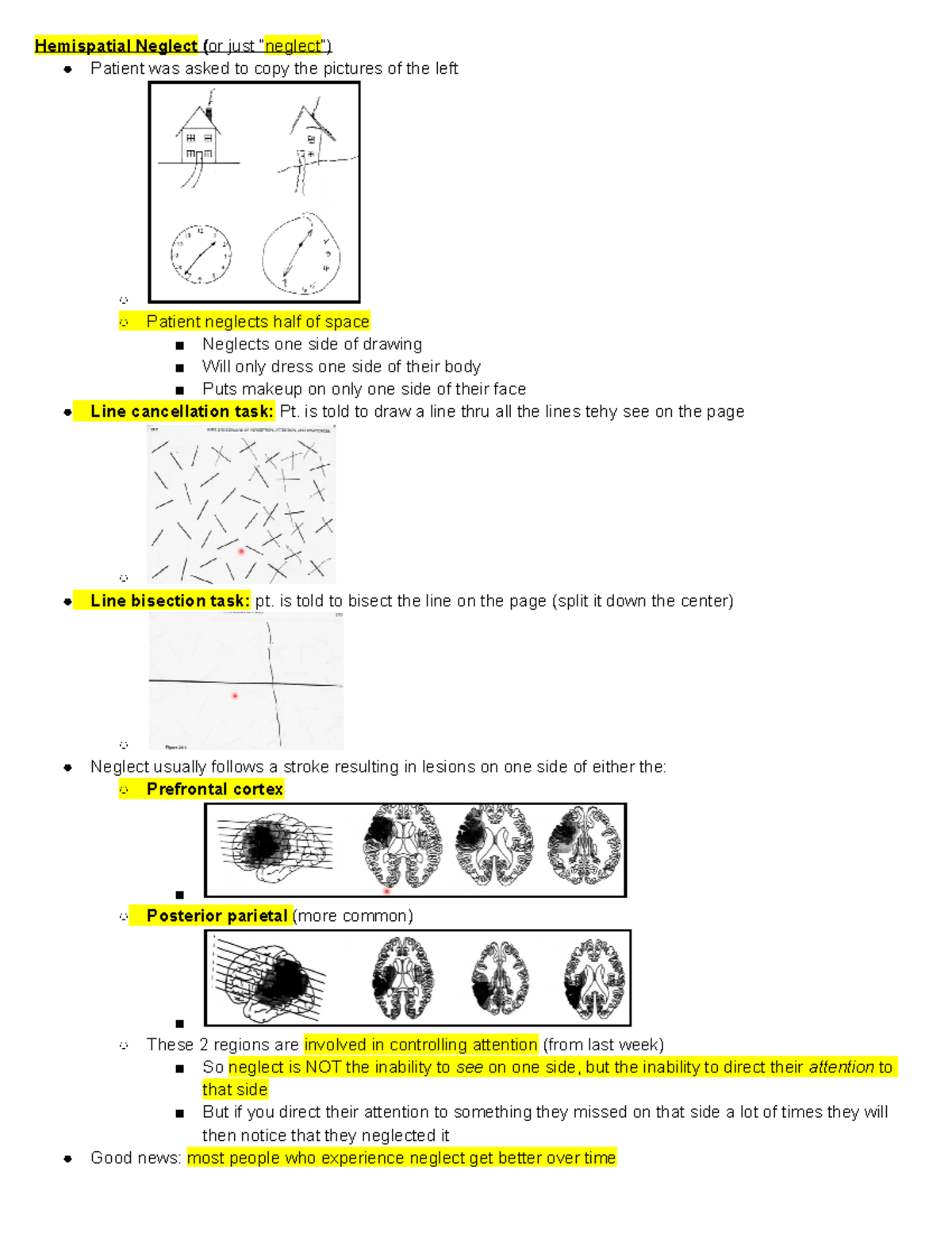 Week 13 - Lecture notes 13 - Hemispatial Neglect ( or just “ neglect ...