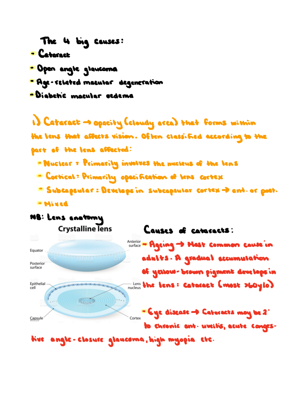 Gradual loss of vision (cataract) - The 4 big causes Cataract Open ...