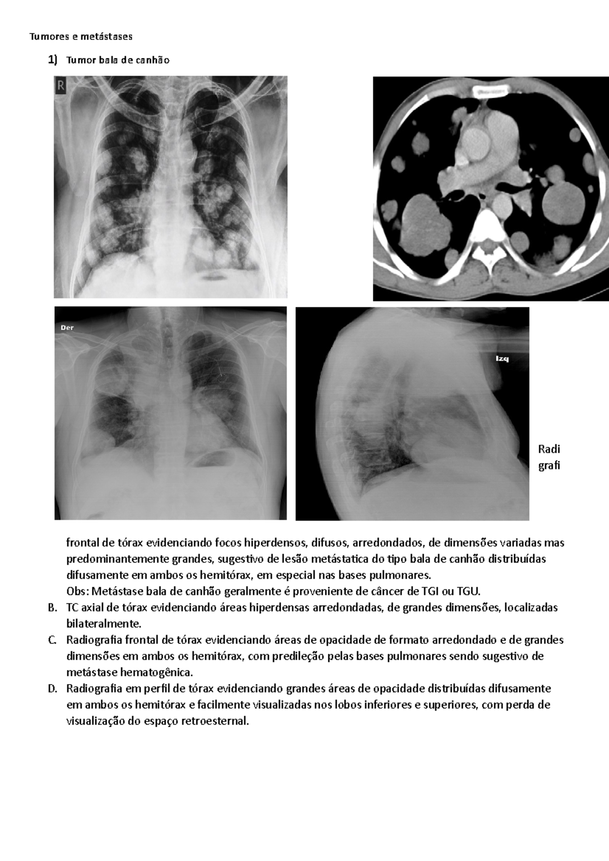 Torax 3 - Imagens descritas - Tumores e metástases 1) Tumor bala de ...