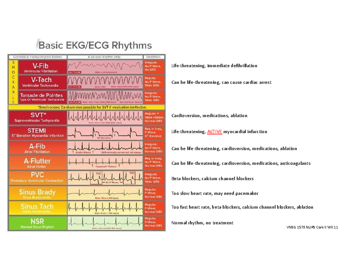 Basic EKG ECG Rhythms - VNSG 1578 NURS Care II Wk 11 Life-threatening ...