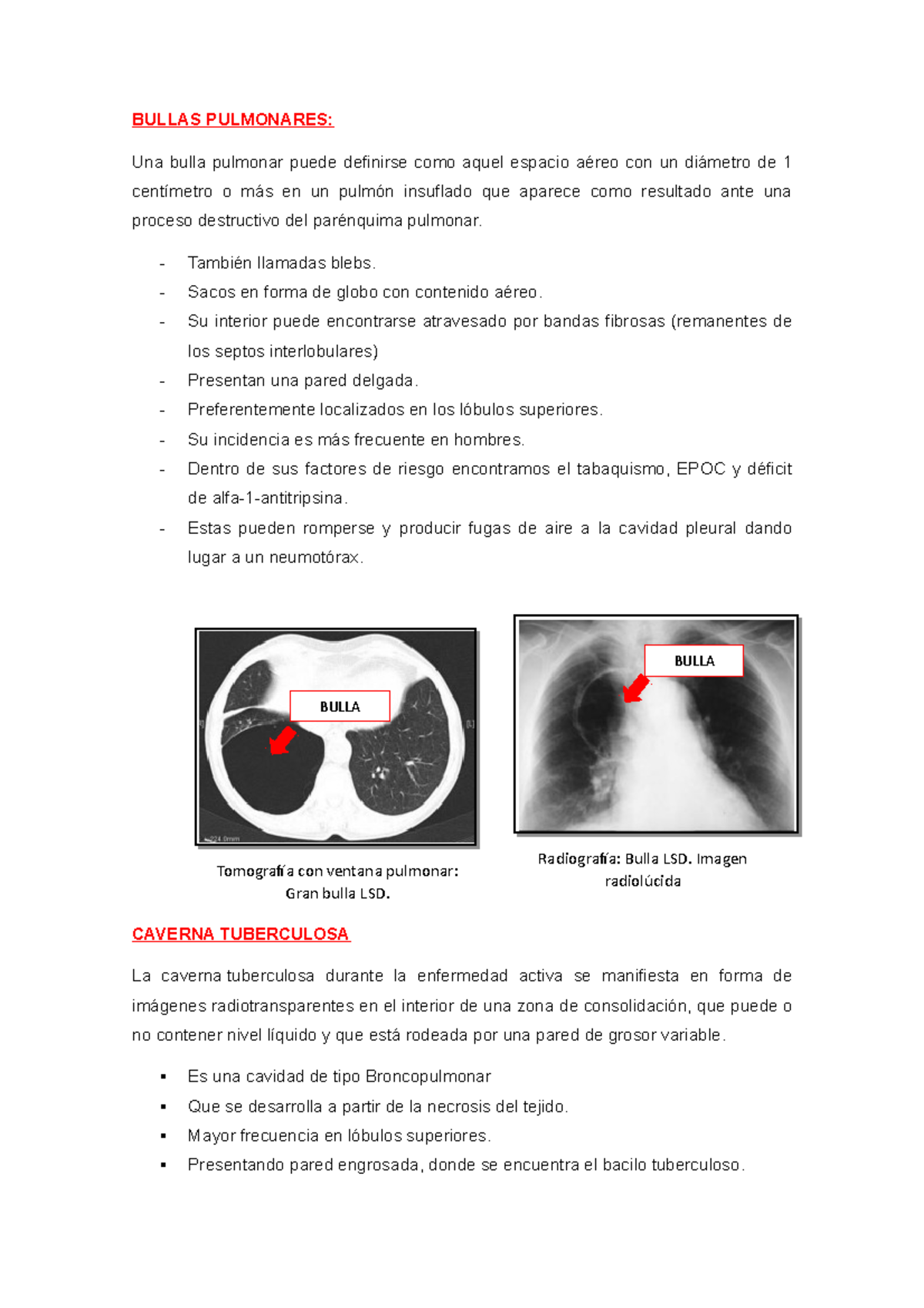 Caverna - Tabajo de DPI - BULLAS PULMONARES: Una bulla pulmonar puede ...