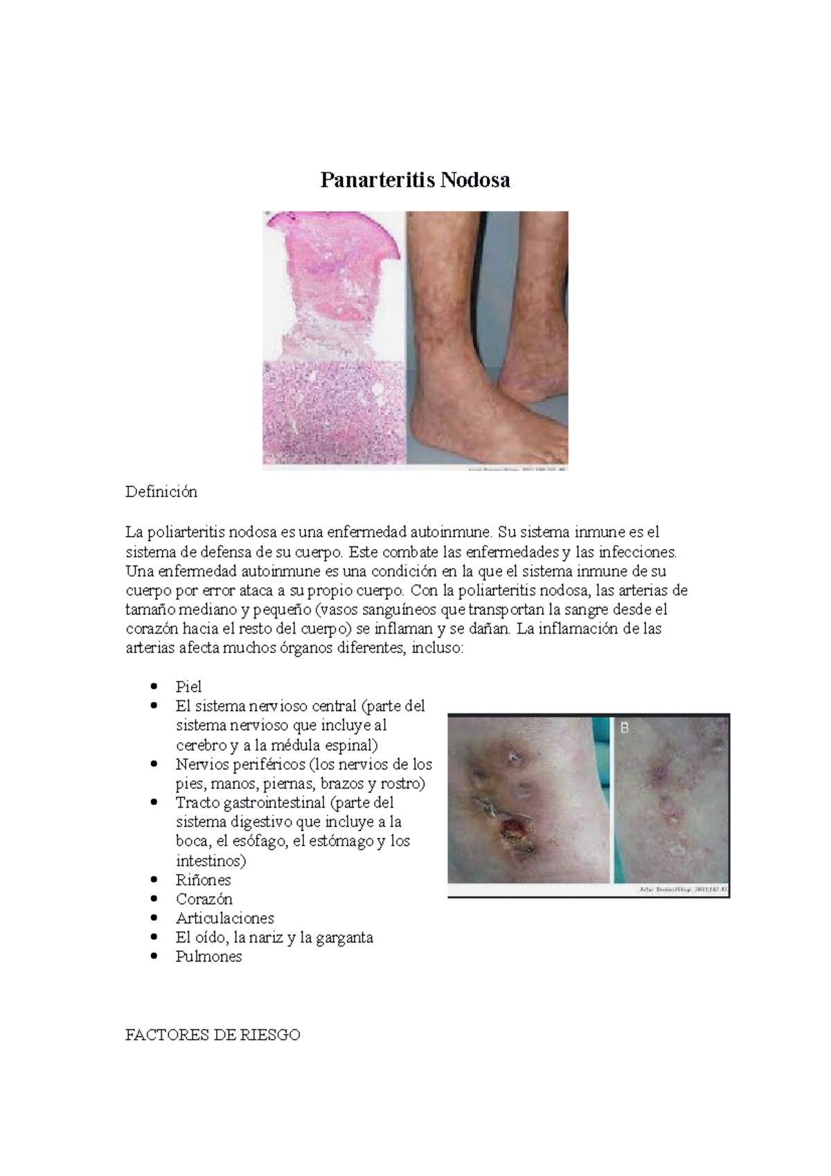 Universidad Estatal DE Guayaquil - Panarteritis Nodosa Definición La ...