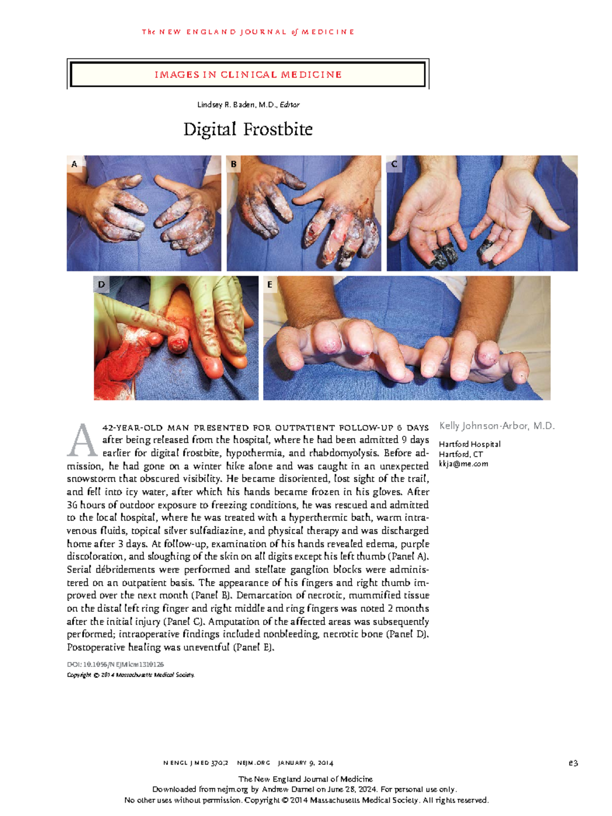 Johnson Arbor 2014 Digital Frostbite - images in clinical medicine T h ...