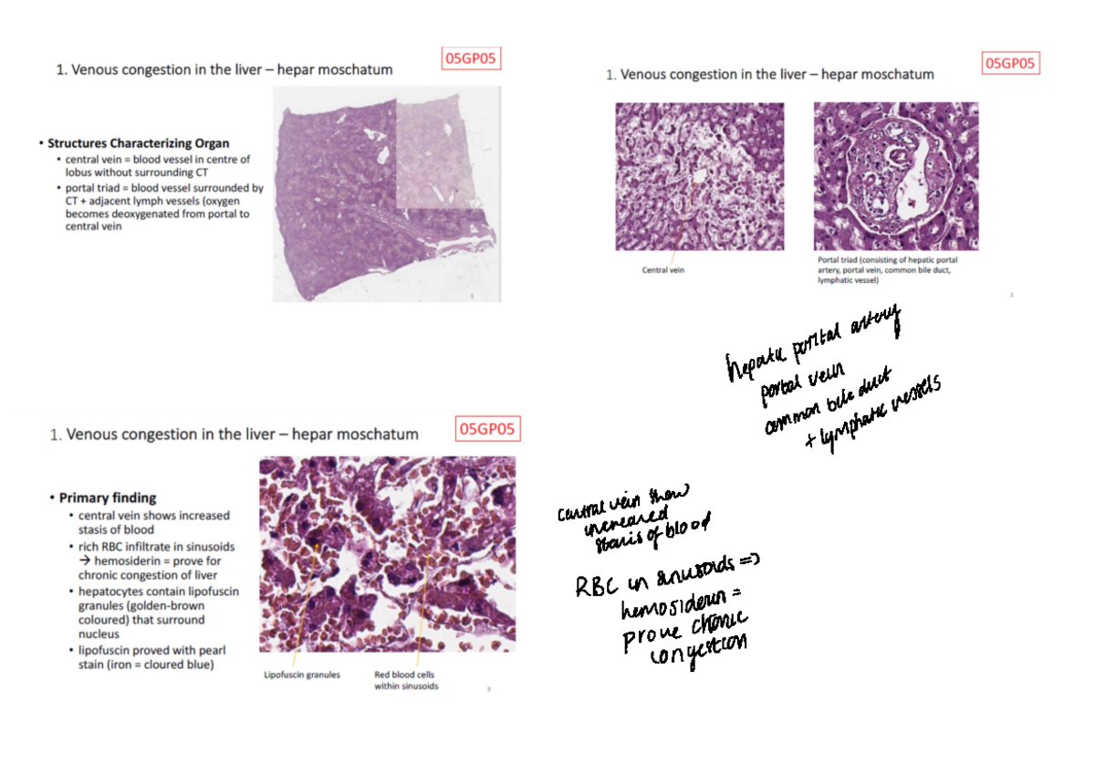 General Pathology Slides - Annotated - hepatic portal artery portal ...