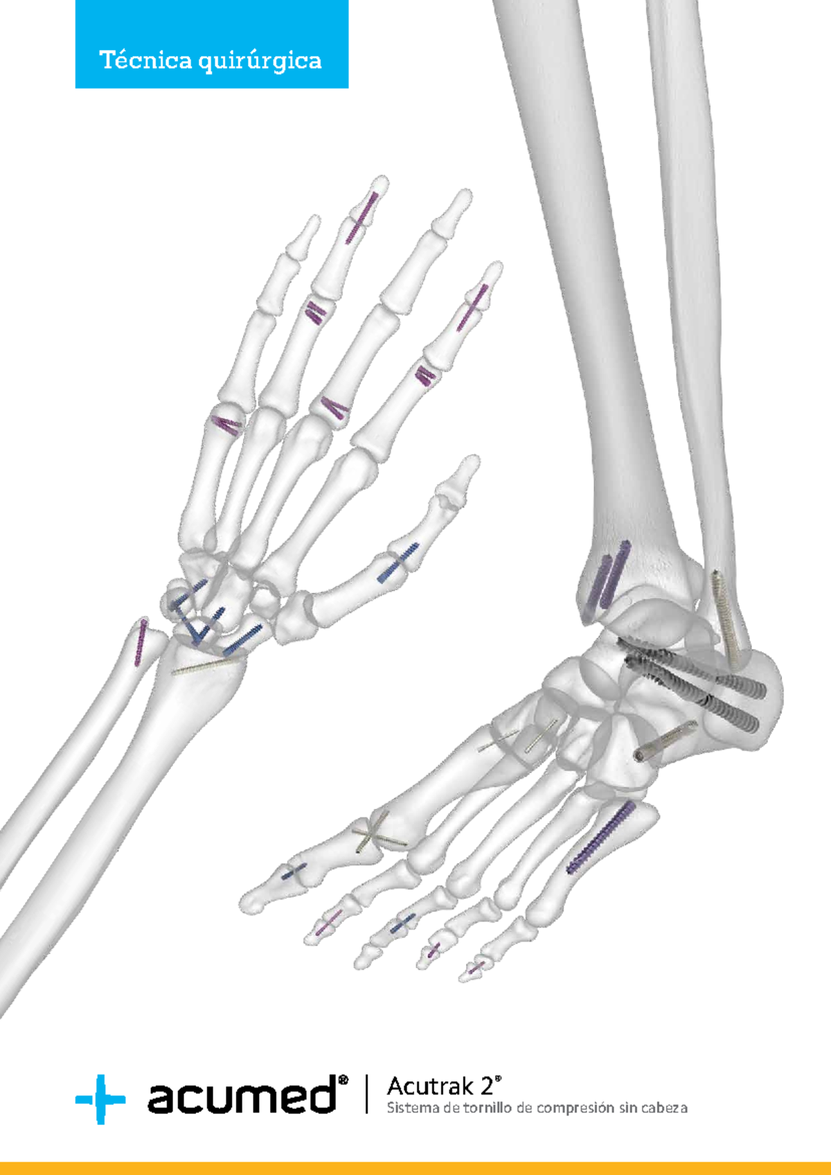 Acumed-surgical-technique-spanish-acutrak-2 - Acutrak 2 ® Sistema de ...