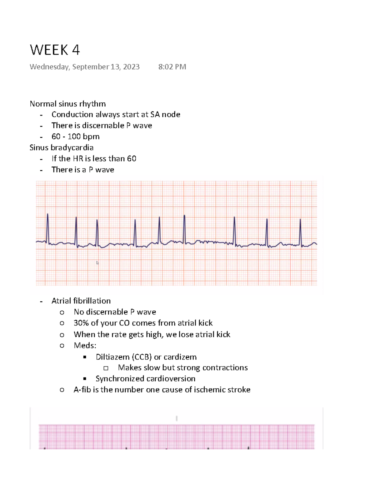 N480 WEEK 4 Tutoring - Normal sinus rhythm Conduction always start at ...