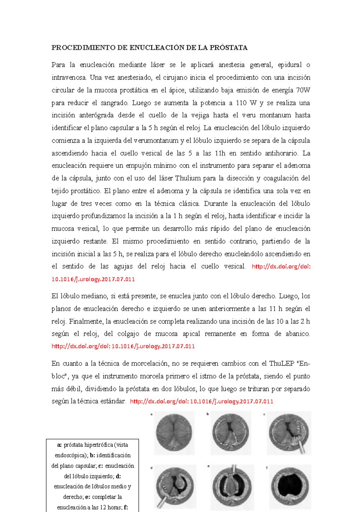 Procedimiento Parte 3 - PROCEDIMIENTO DE ENUCLEACIÓN DE LA PRÓSTATA ...