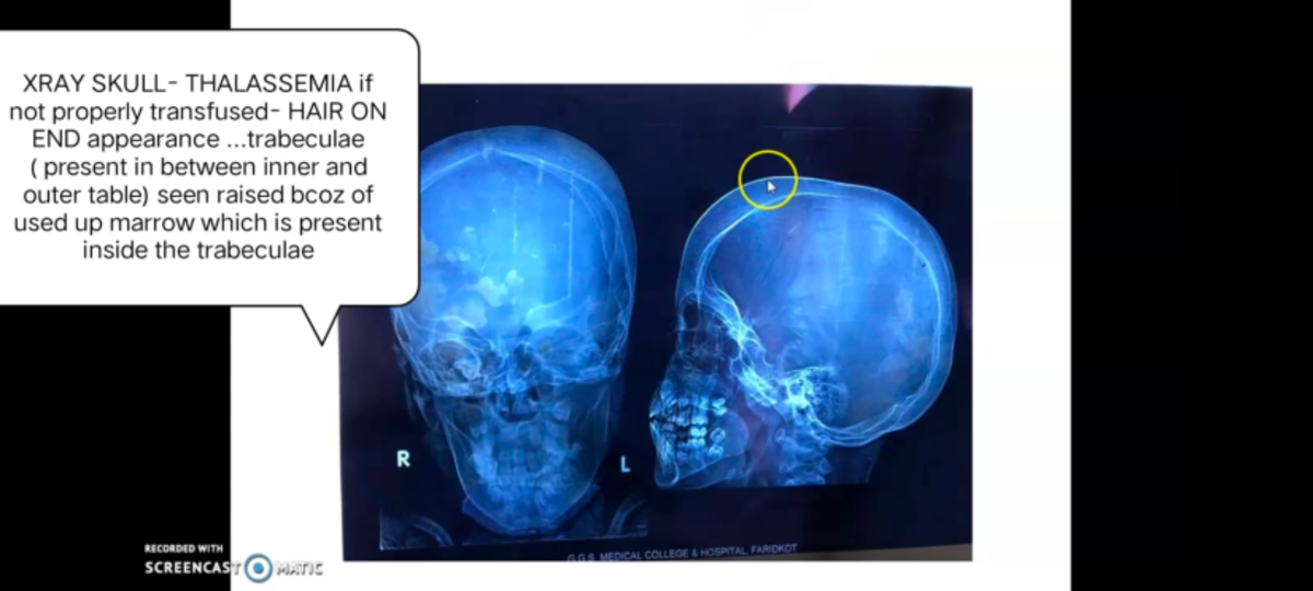 Paeds Practical - XRAY SKULL THALASSEMIA if not properly HAIR ON END ...
