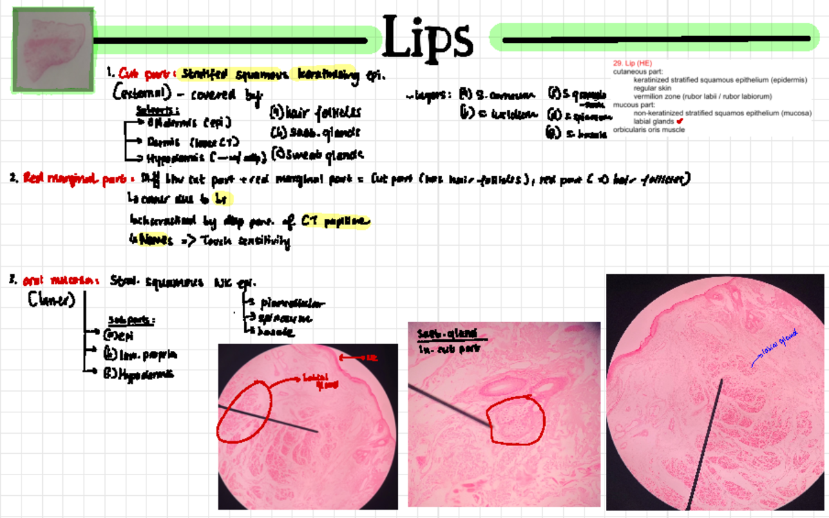 Histo - Cut part : strati fed squamous keratin ising epi . (external ...