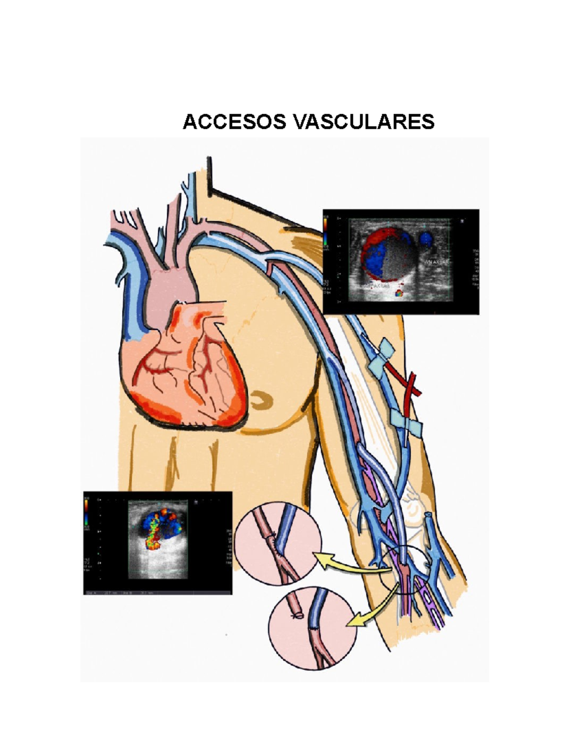 Accesos Vasculares (1) Revisado Listo - ACCESOS VASCULARES ACCESOS VASCULARES Un acceso vascular ...