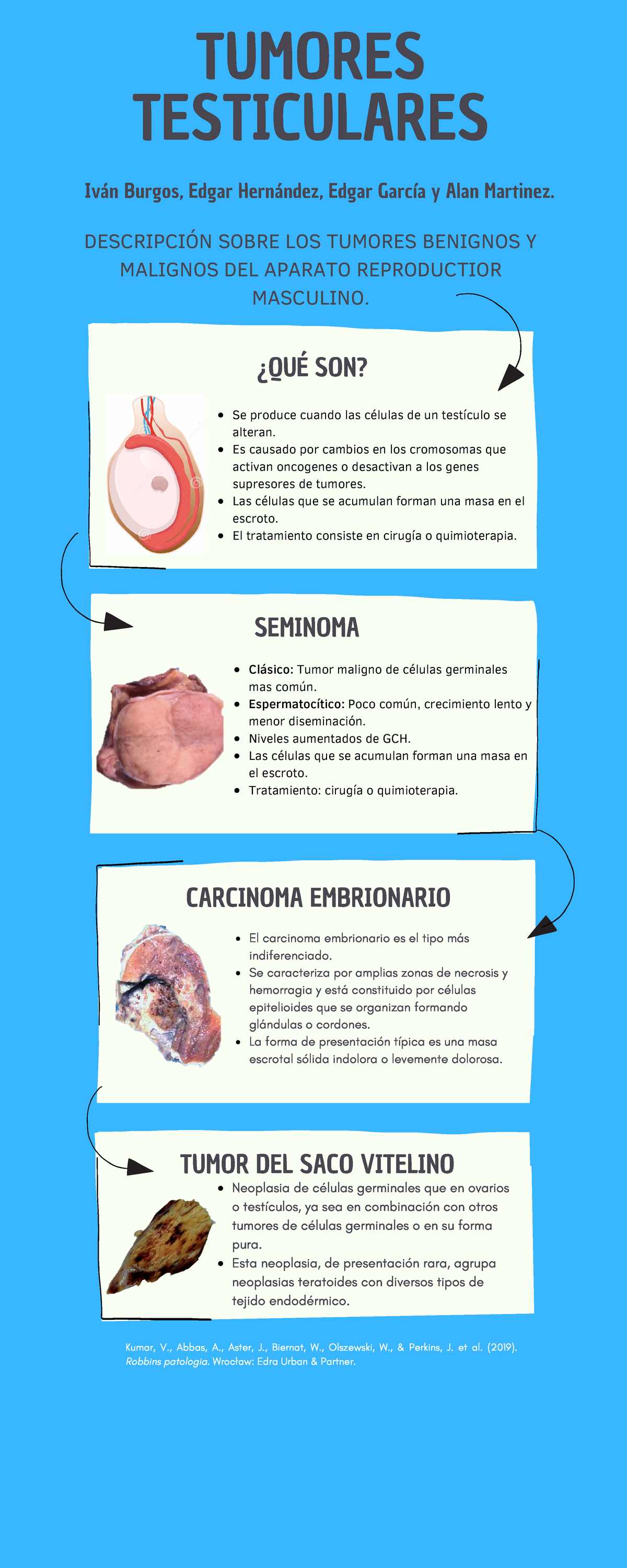 Tumor Do Saco Vitelino Corpos De Schiller Duval Shuller Duval Bodies