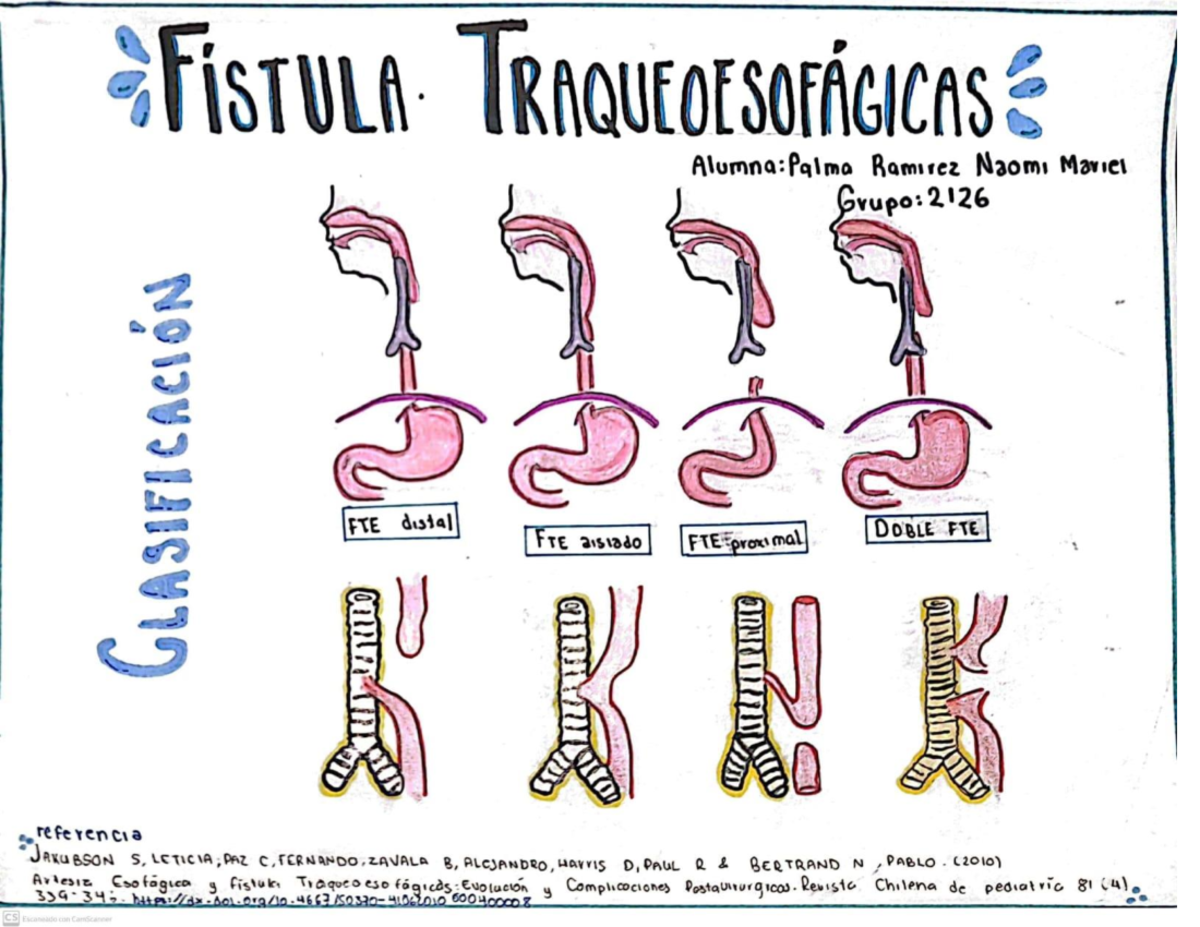 Clasificación de la fístula traqueoesofágicas Palma Ramirez Naomi ...