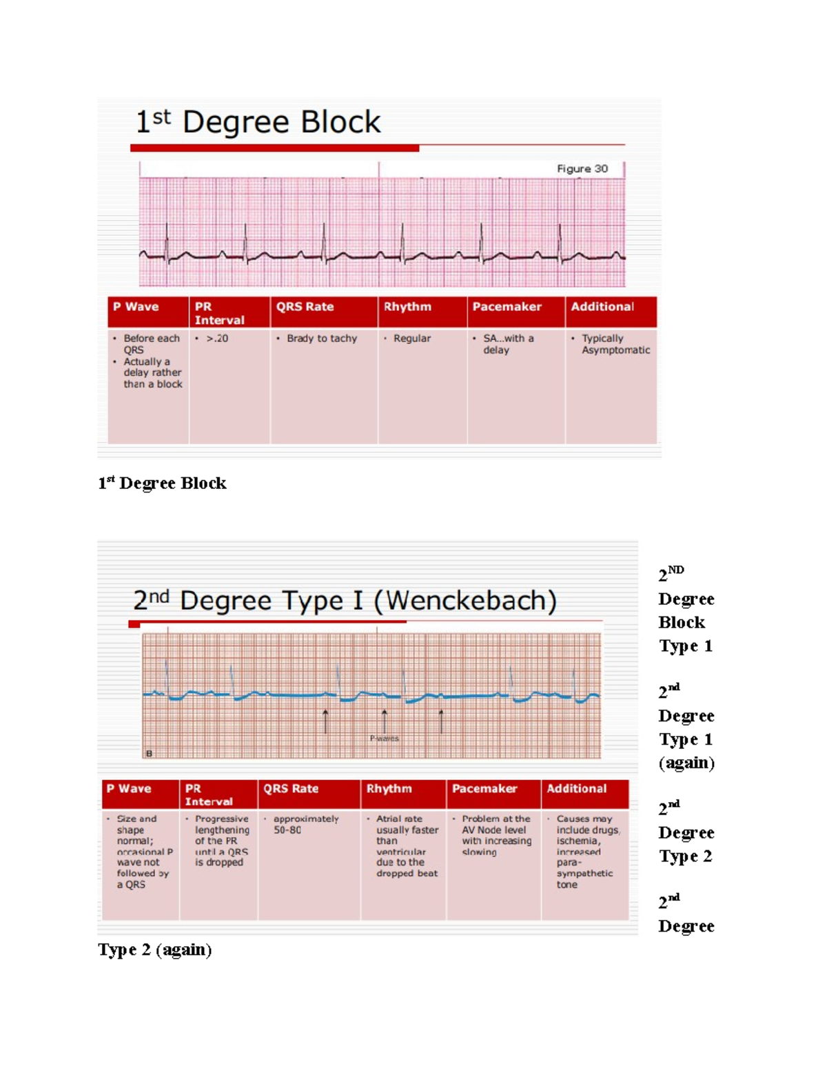 Concept map and heart rhythms - 1 st Degree Block 2 ND Degree Block ...