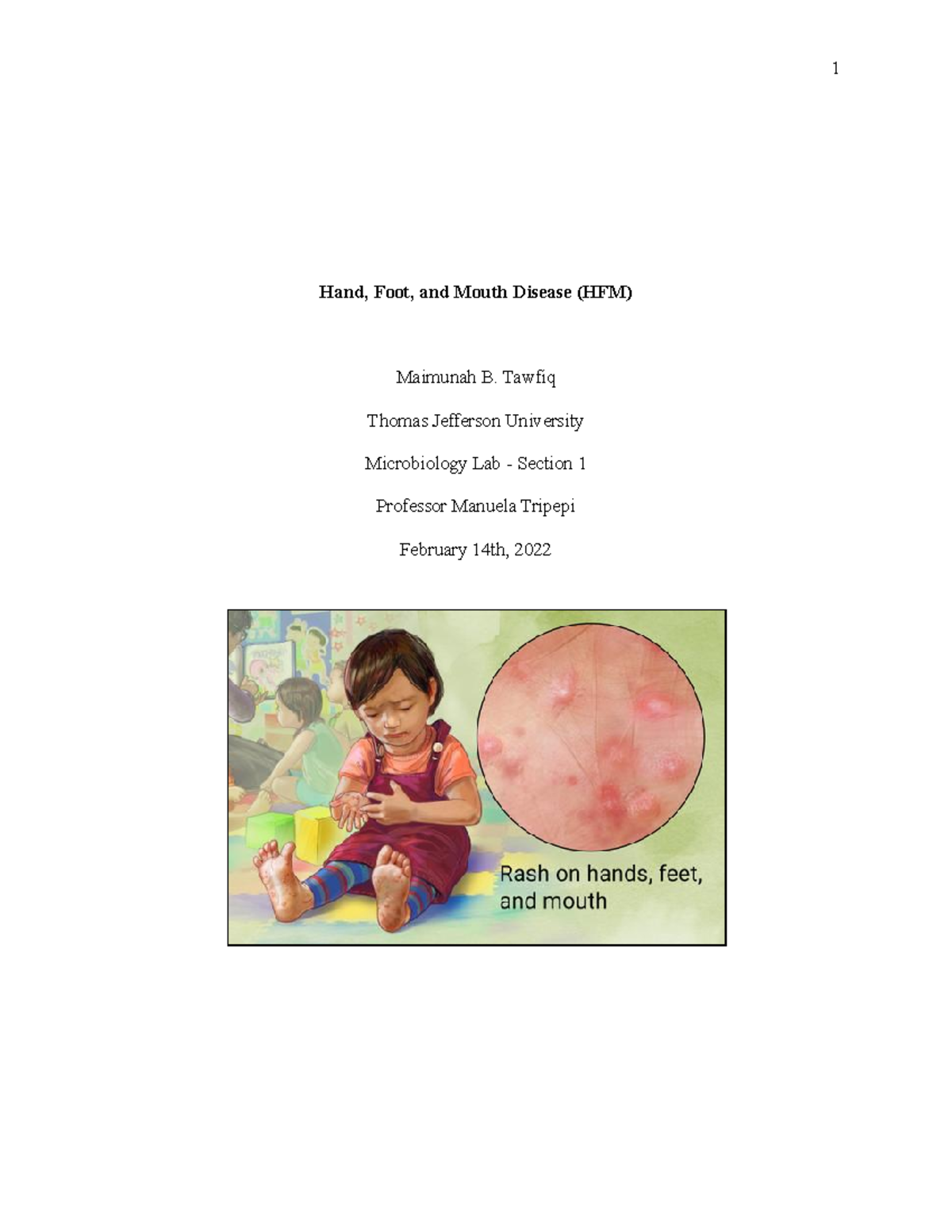 Hand, Foot, Mouth Disease Writing Assignment - Microbiology Lab - Hand ...