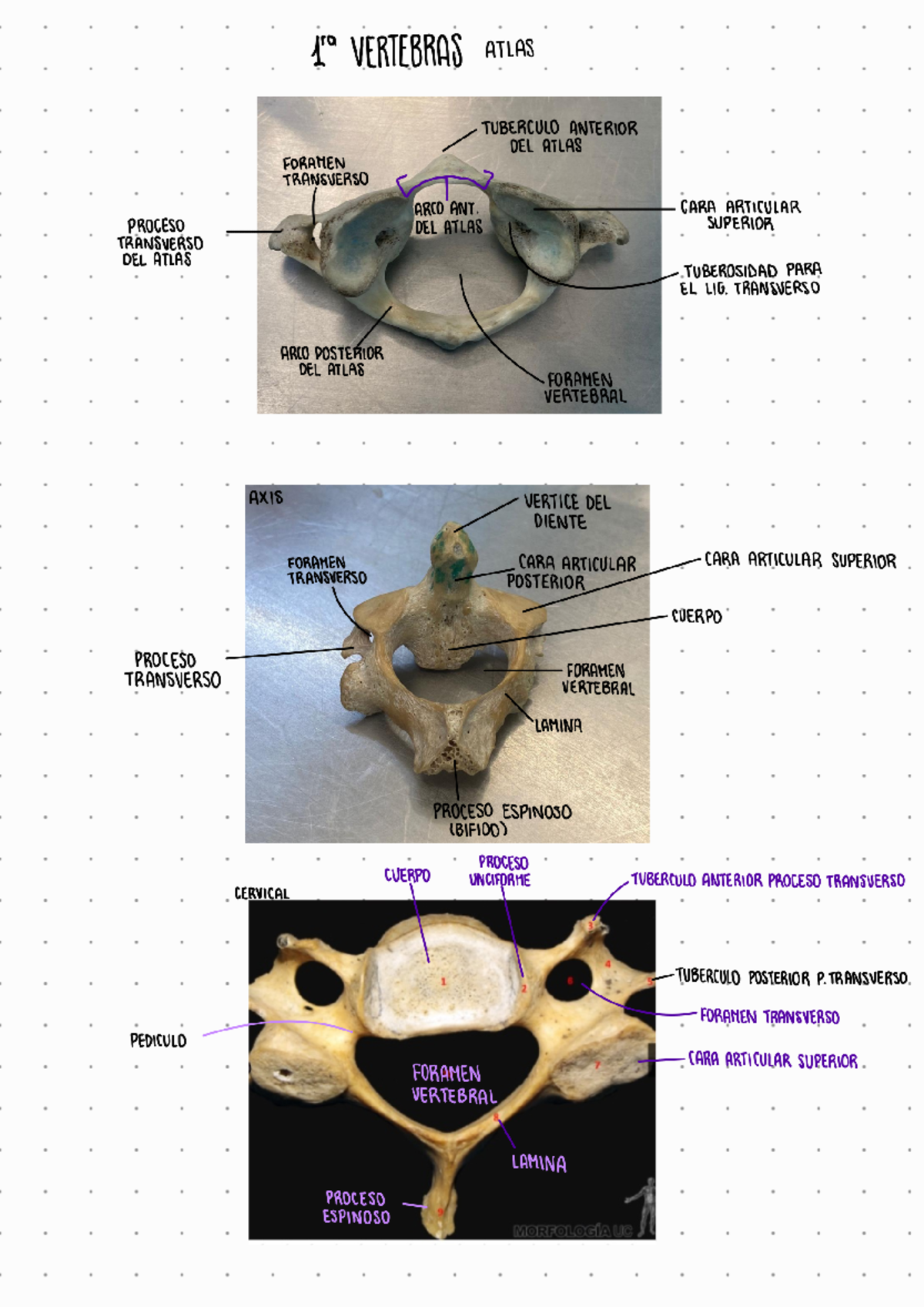 Rotulado - 1rd VERTEBRAS ATLAS TUBERCULO ANTERIOR DEL ATLAS FORAMEN ...